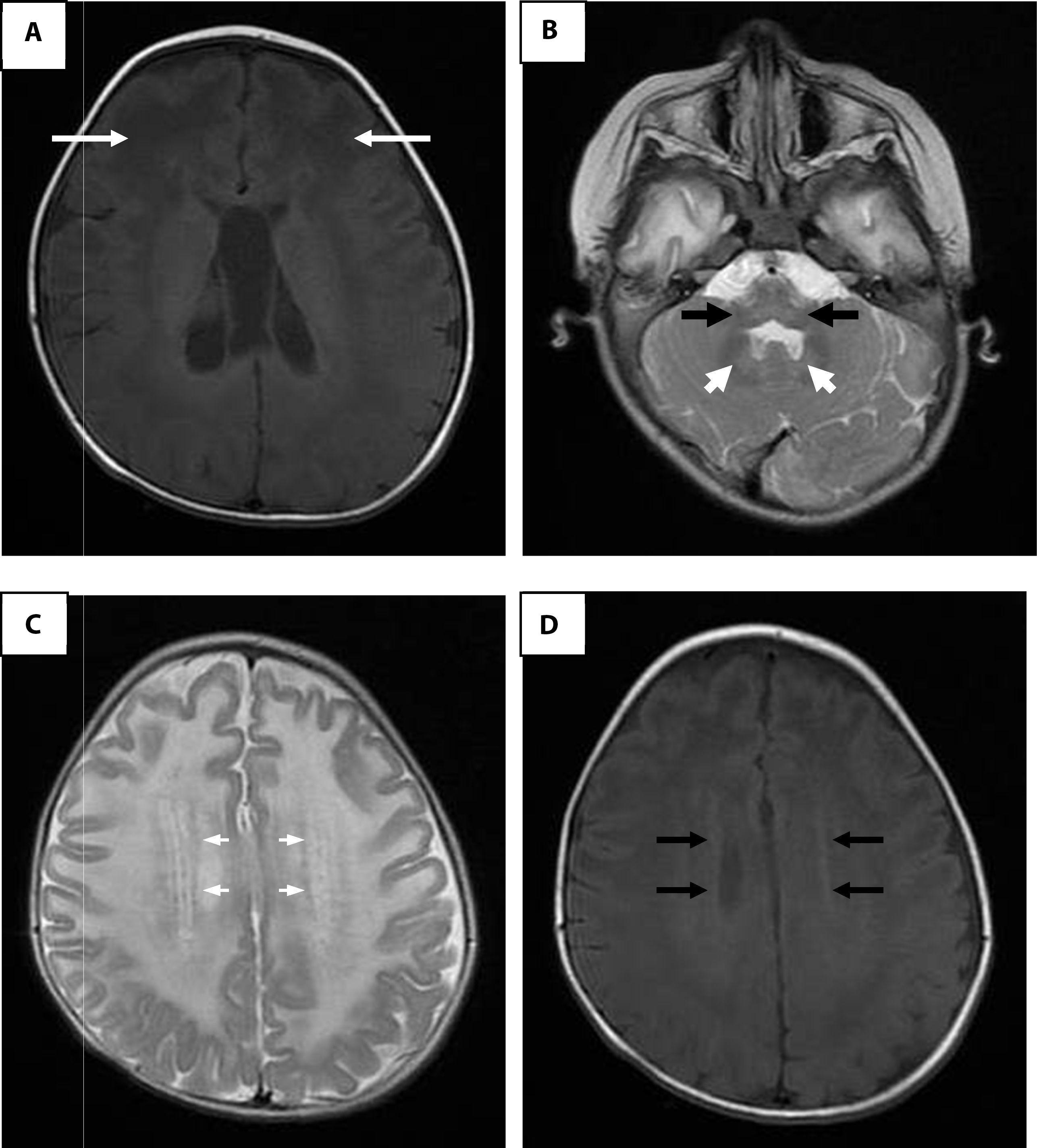 Atypical presentation of infantile Alexander disease without ...