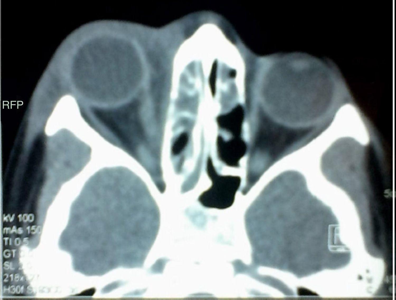 Orbital cellulitis complicated by subperiosteal abscess due to ...