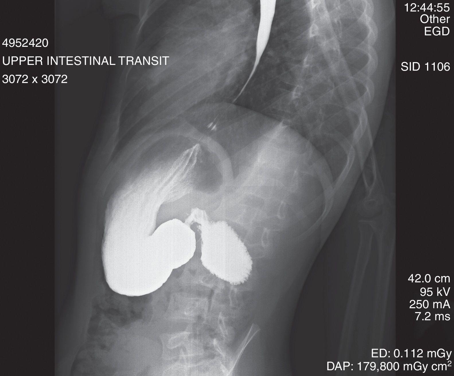 Fenestrated duodenal web treated by endoscopic dilatation ...