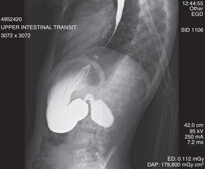 Fenestrated duodenal web treated by endoscopic dilatation ...