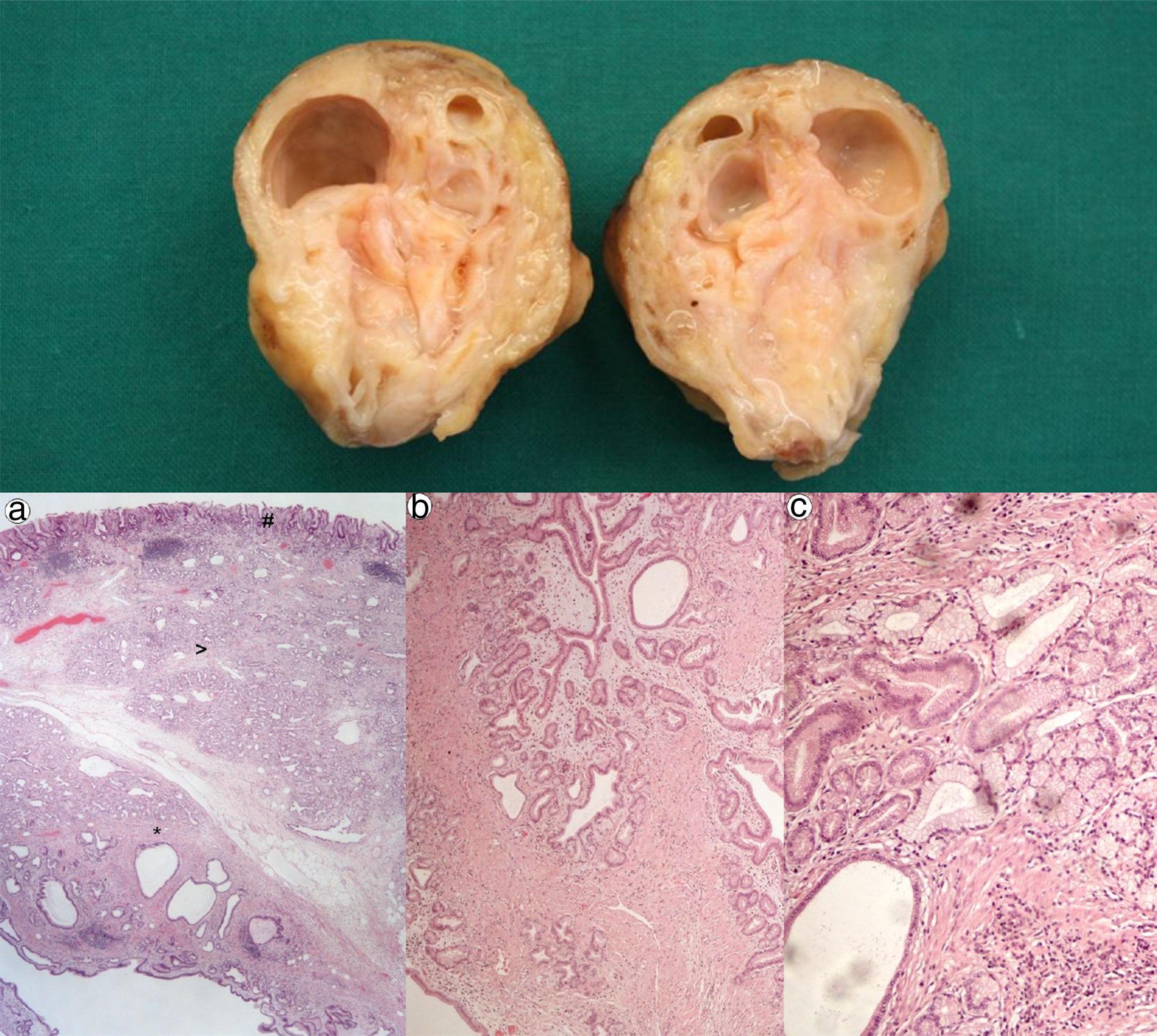 Gastritis cystica profunda mimicking a GIST – A diagnostic challenge ...