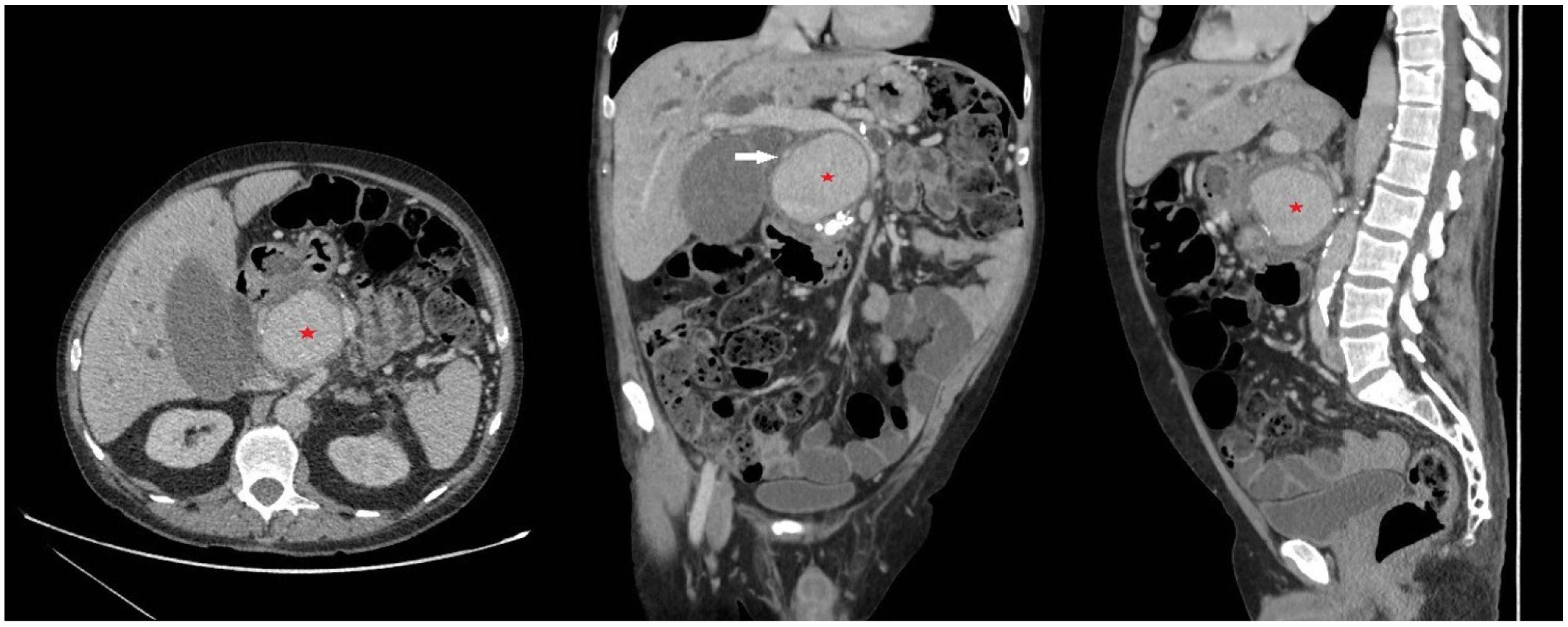 Obstructive jaundice secondary to a pseudoaneurysm in anatomical ...