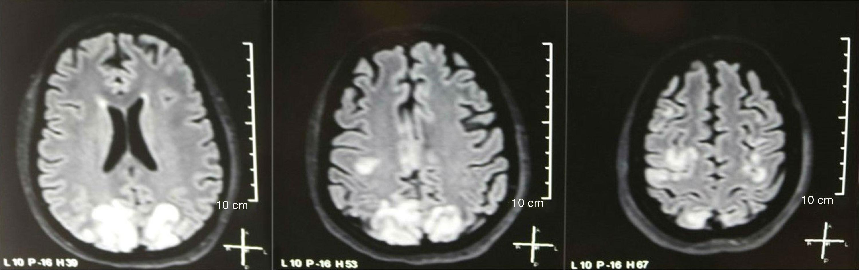 Diagnosis and management of posterior reversible encephalopathy ...