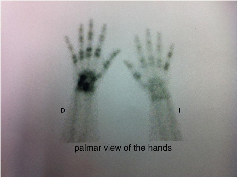 Asymmetrical arthritis with ray pattern distribution | Revista ...