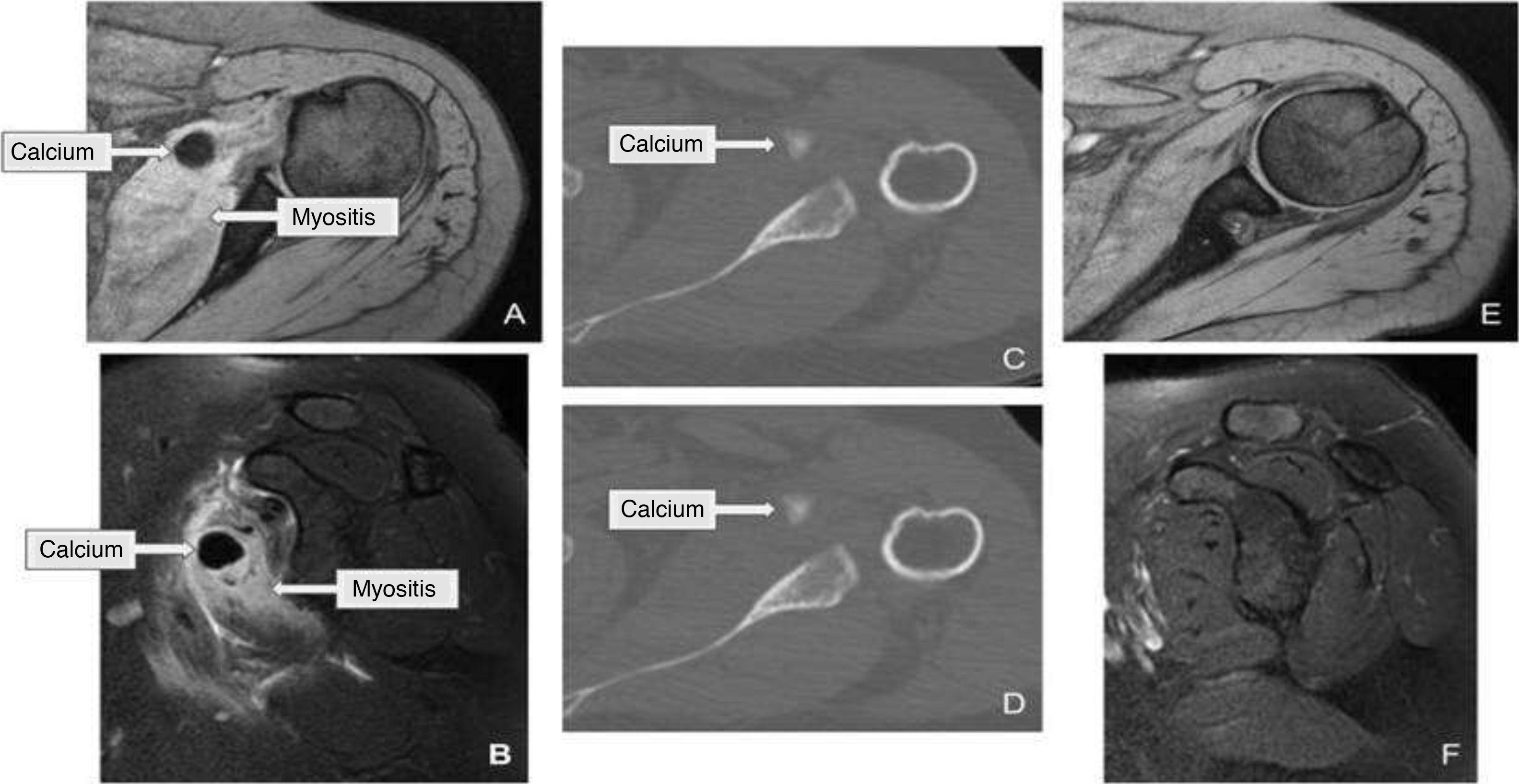Subscapularis myositis: An uncommon complication in calcific ...