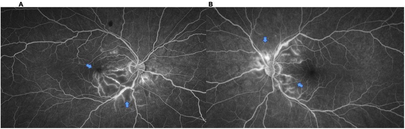 Purtscher-like retinopathy with bilateral vasculitis and vascular ...