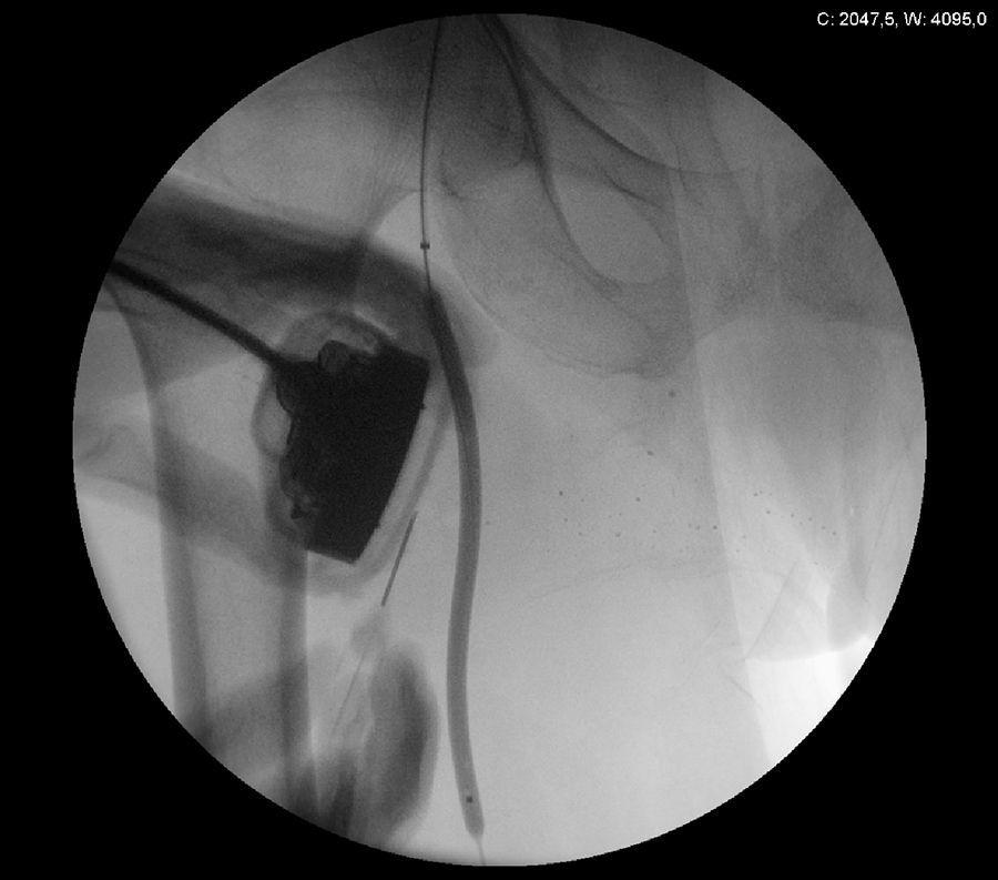 Temporary aneurysm neck balloon occlusion during percutaneous thrombin ...