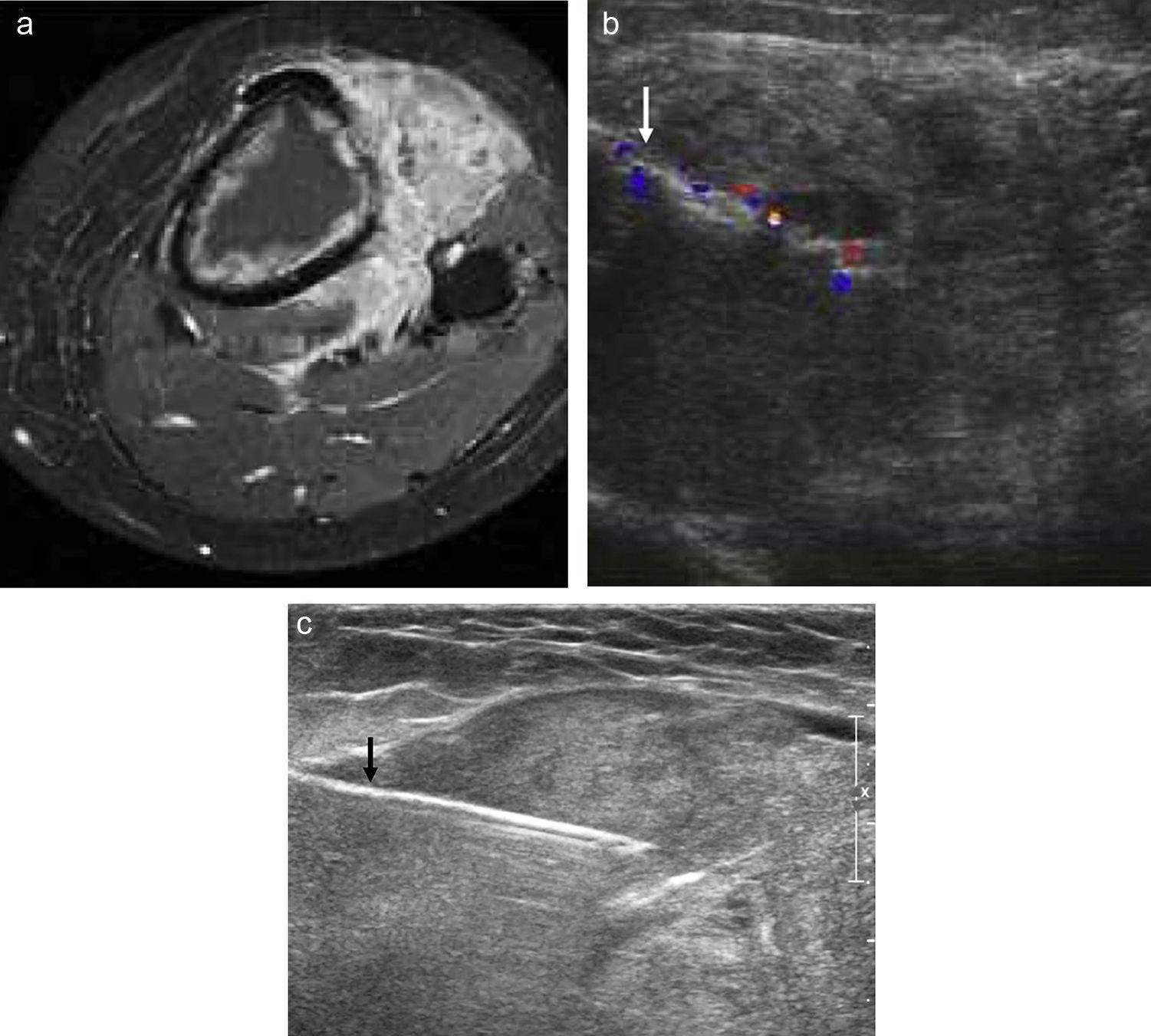 Técnicas de la biopsia correcta en el aparato locomotor | Revista ...