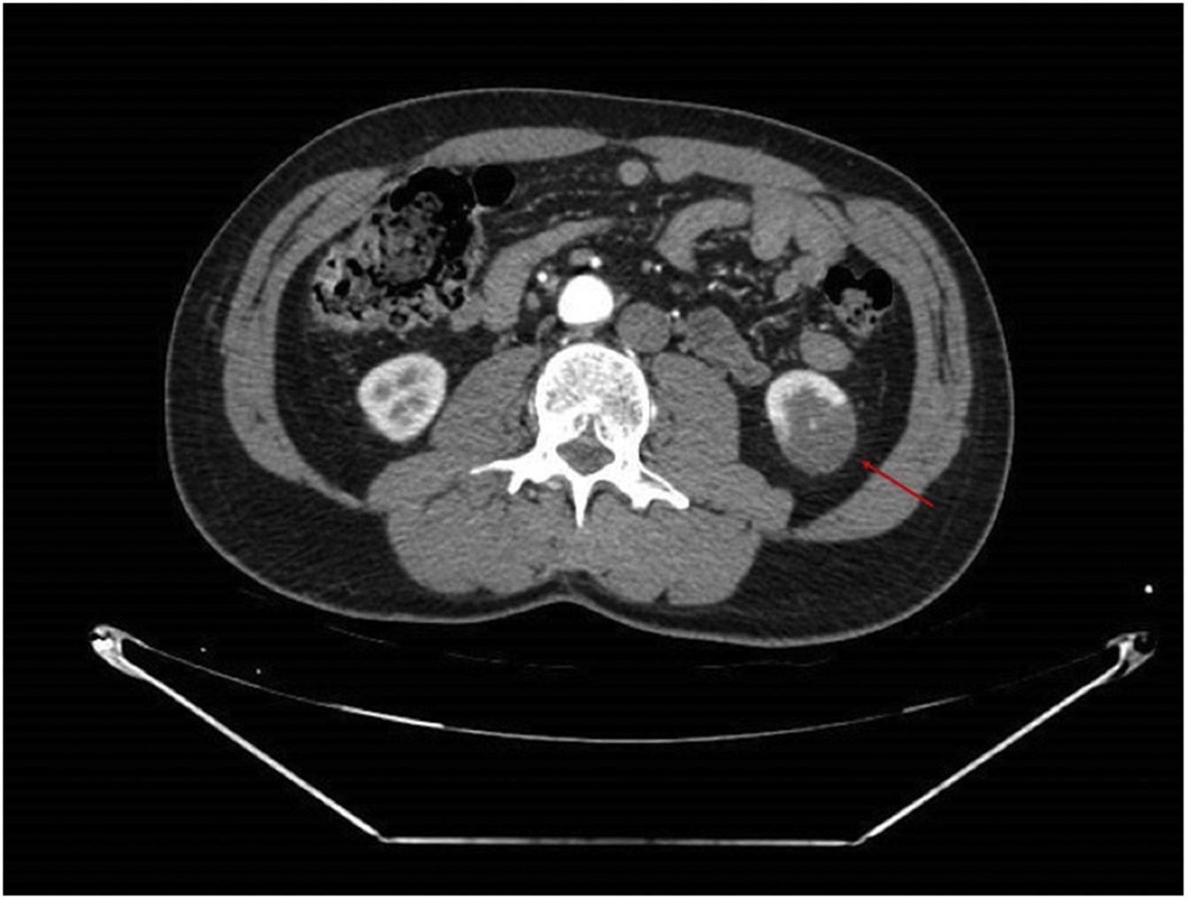 Who shot first? Three possible causes of a kidney infarction | Clínica ...