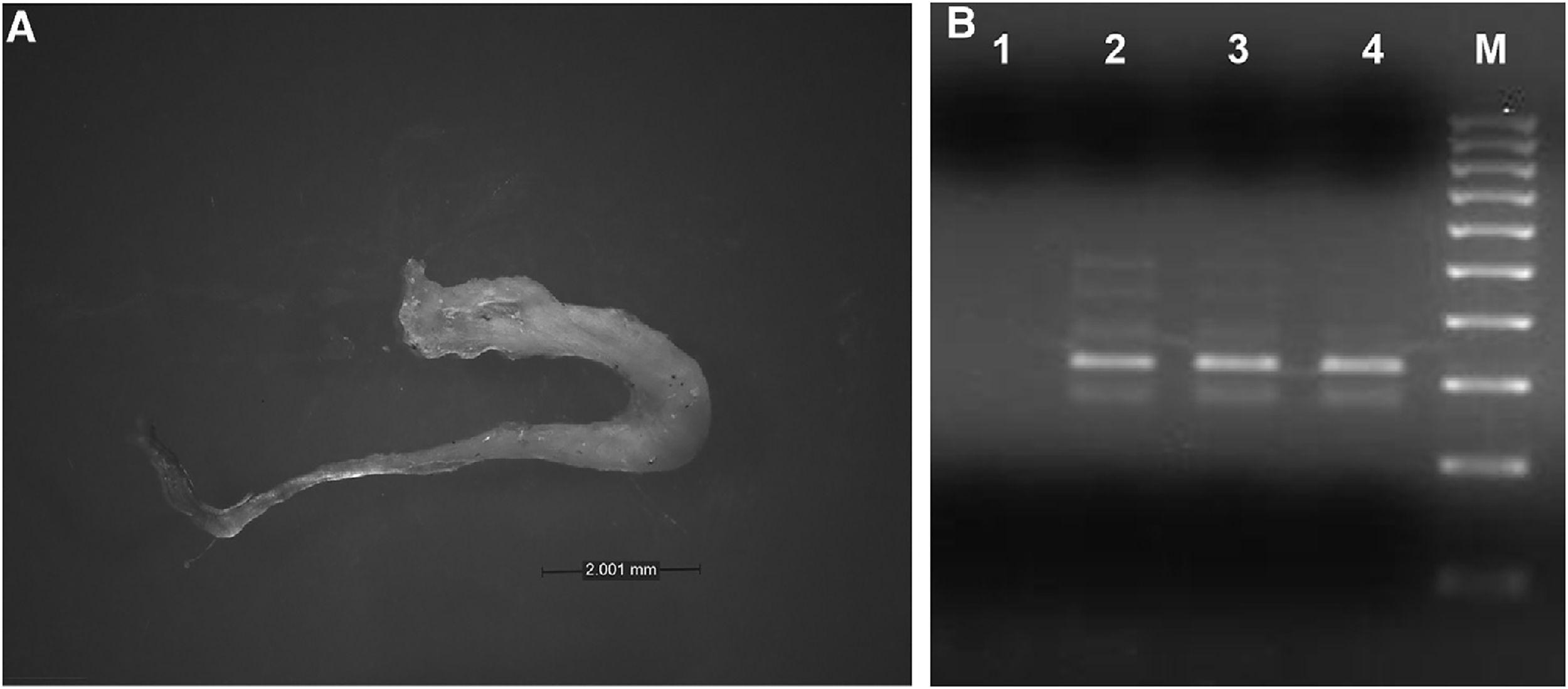 A case of human ocular dirofilariasis in a patient with multiple ...