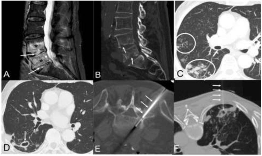 Disseminated Mycobacterium avium complex infection: microbiological ...