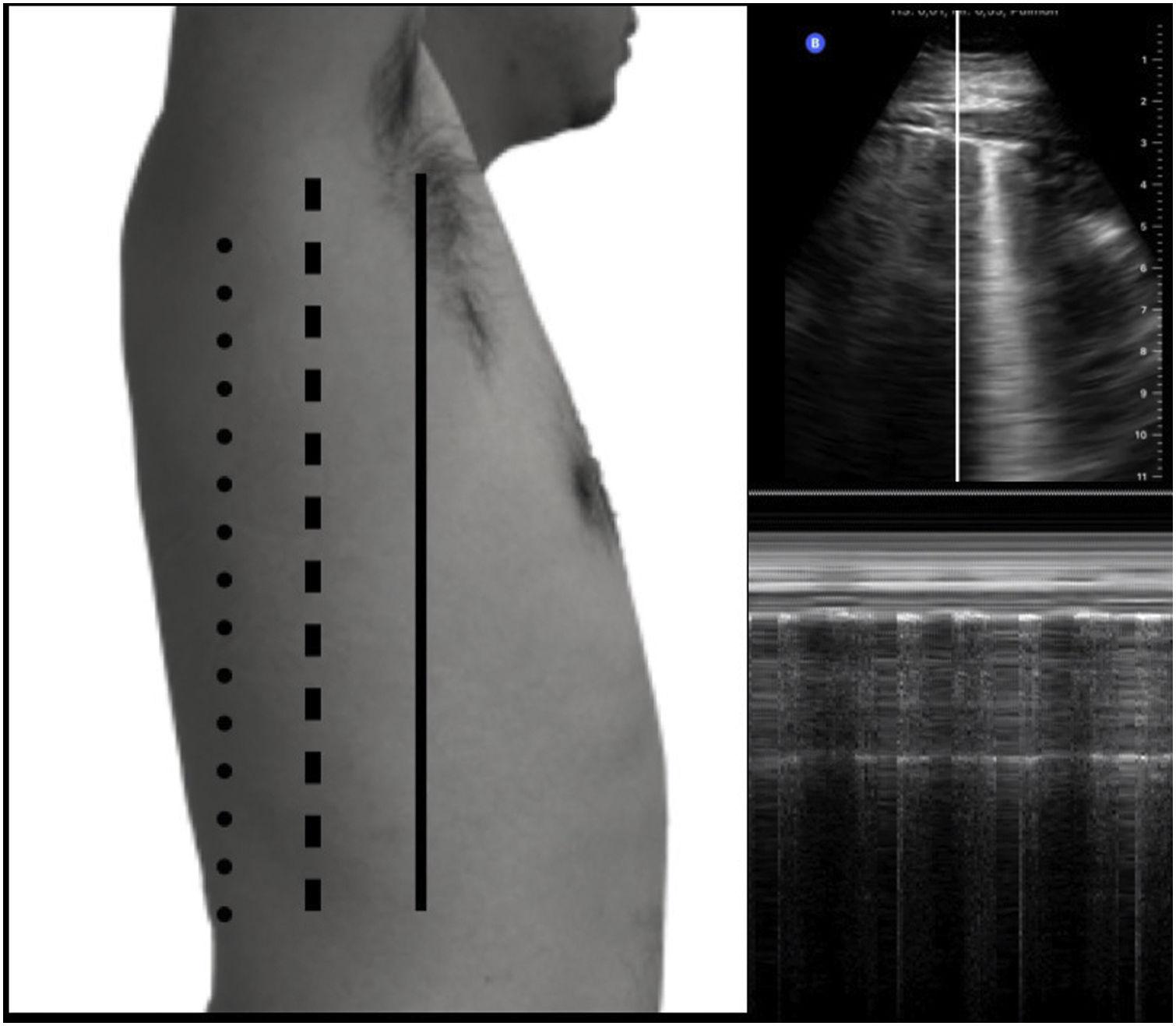 Detection and semiquantification of pneumothorax through lung ...