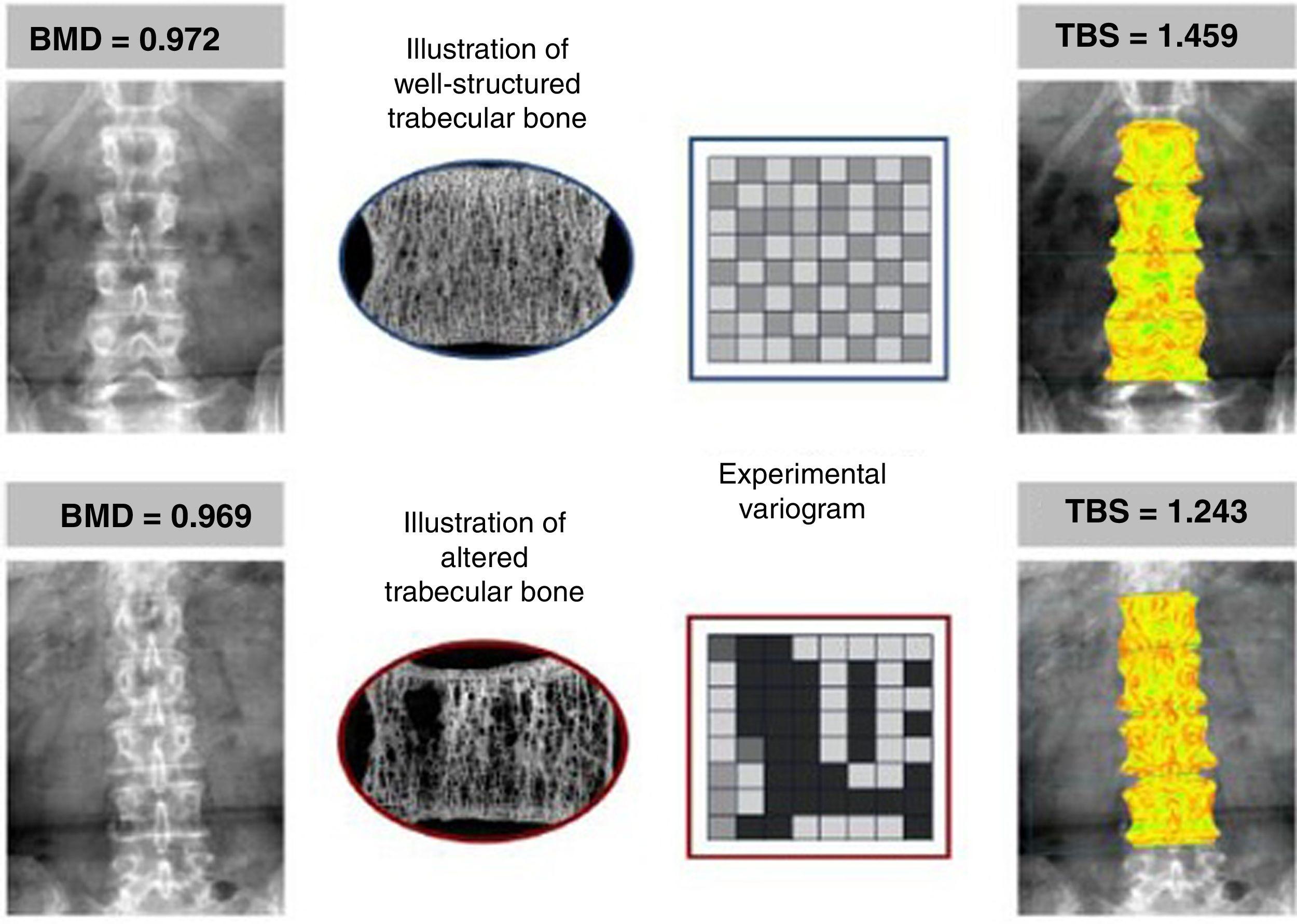 New technologies in the evaluation of bone fragility and their ...