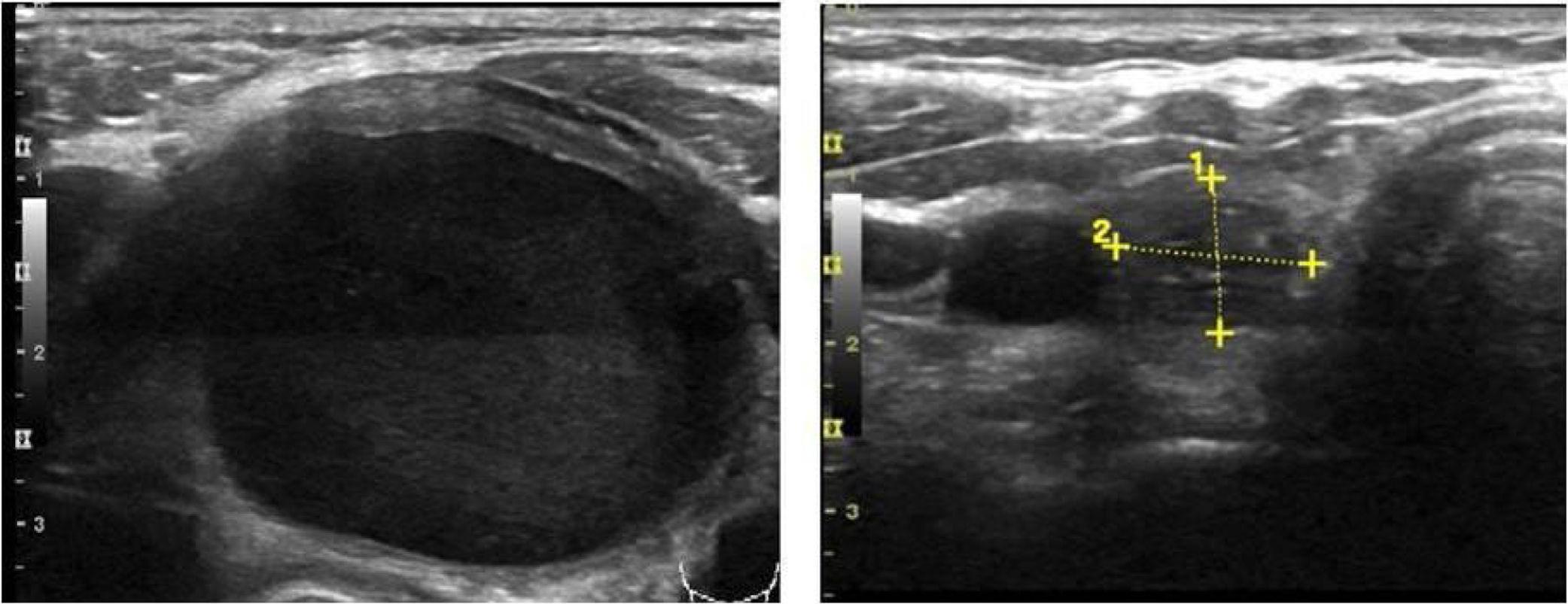 Thyroid Ultrasound Cyst