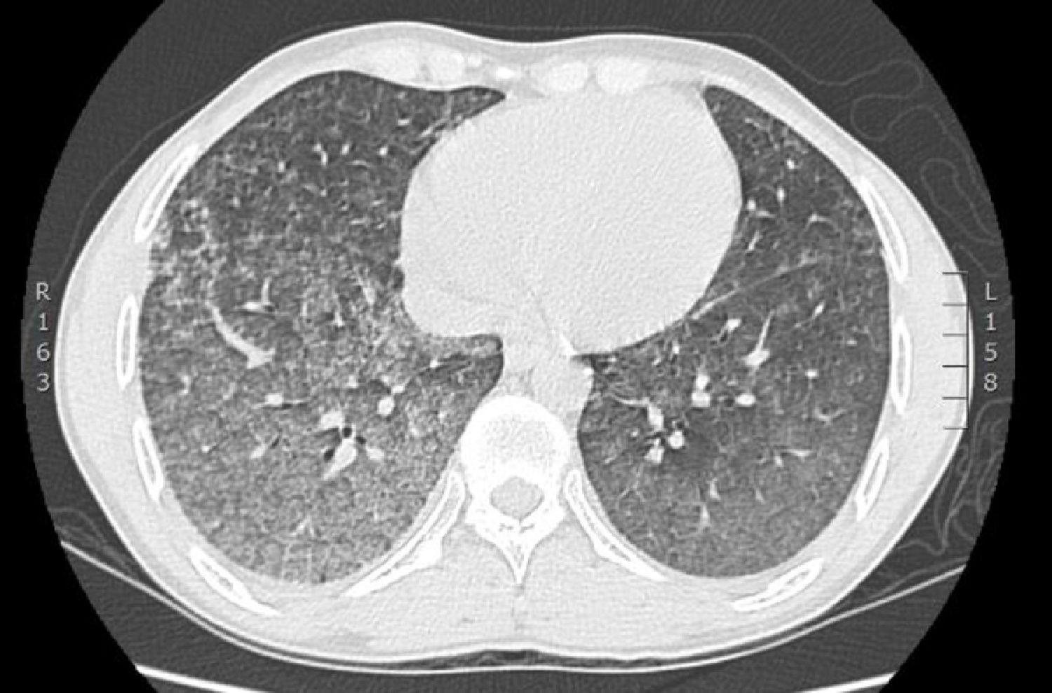 Fat embolism syndrome presenting as diffuse alveolar hemorrhage: a rare ...