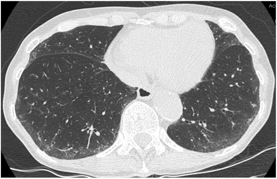 Novelties in imaging in pulmonary fibrosis and nodules. A narrative ...