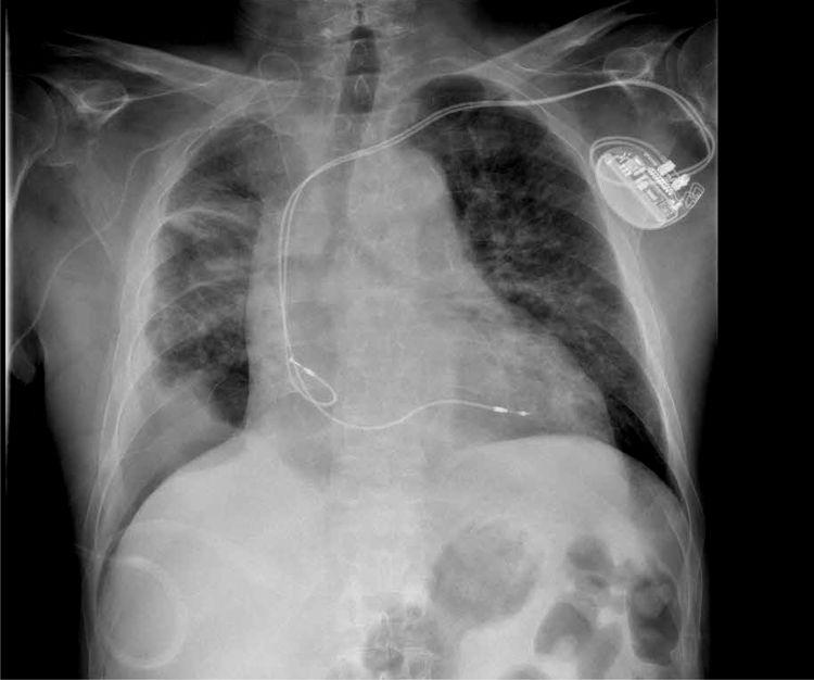 Novel complications of the tunnelled indwelling pleural catheter ...