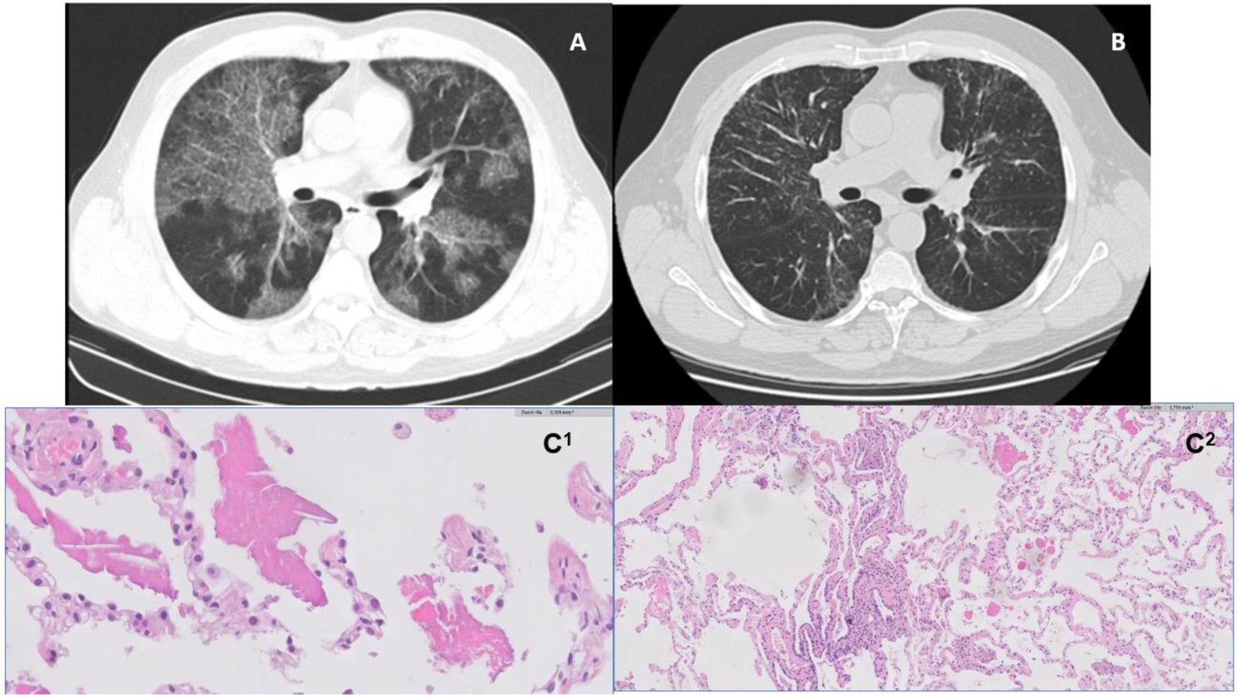 Hypersensitivity pneumonitis in a patient with pulmonary alveolar ...