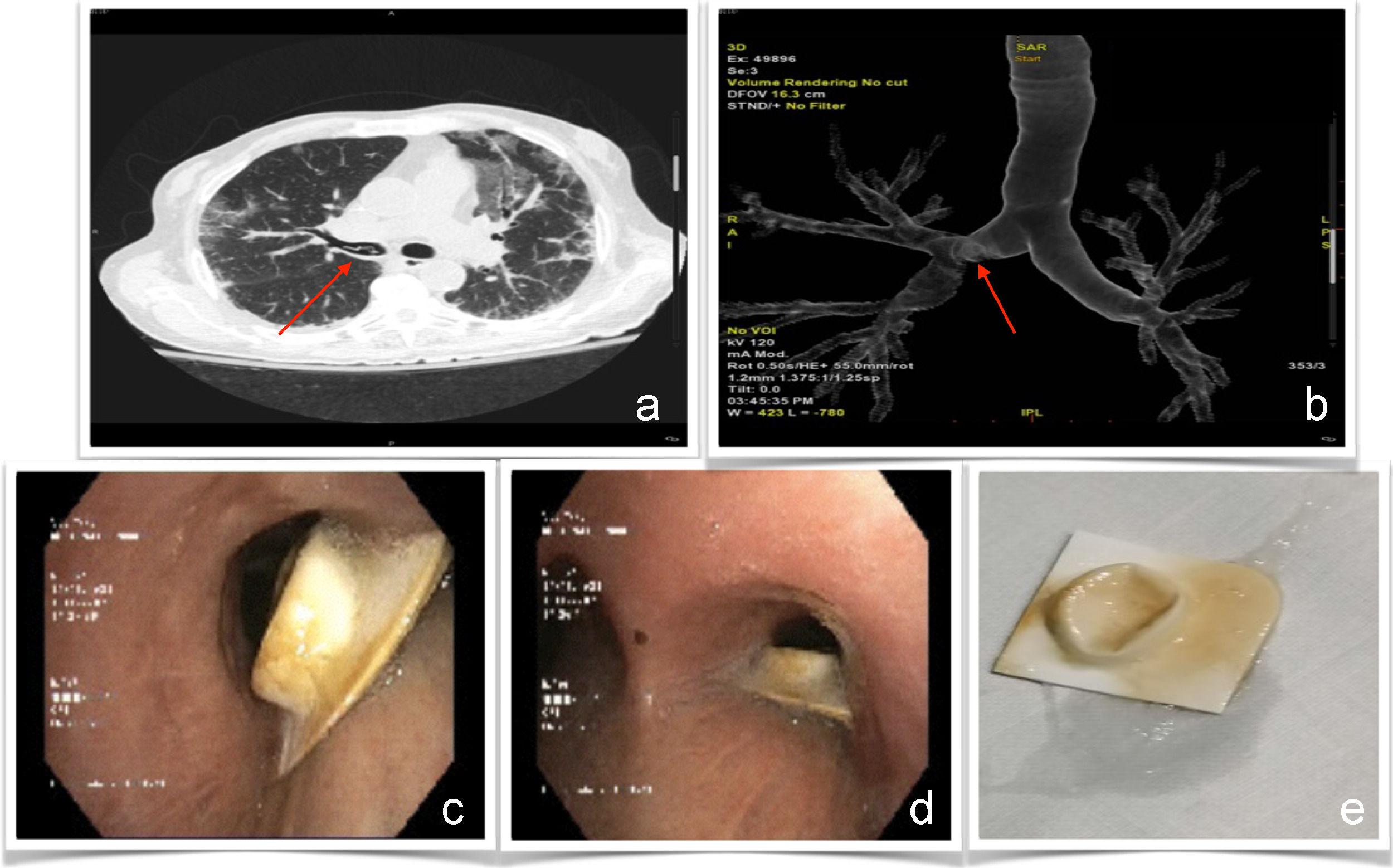 Foreing body bronchoaspiration in adult: Pharmaceutical blister ...