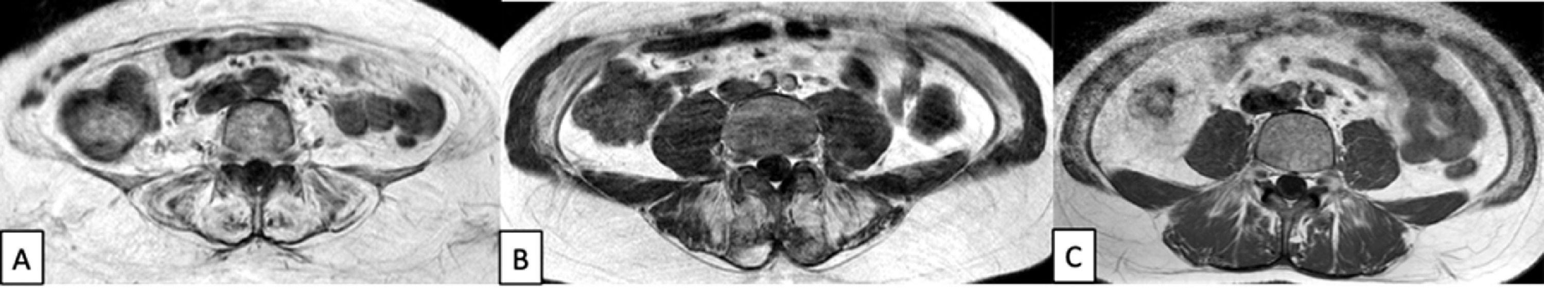 Late-onset Pompe disease (LOPD): May axial myopathy influence ...