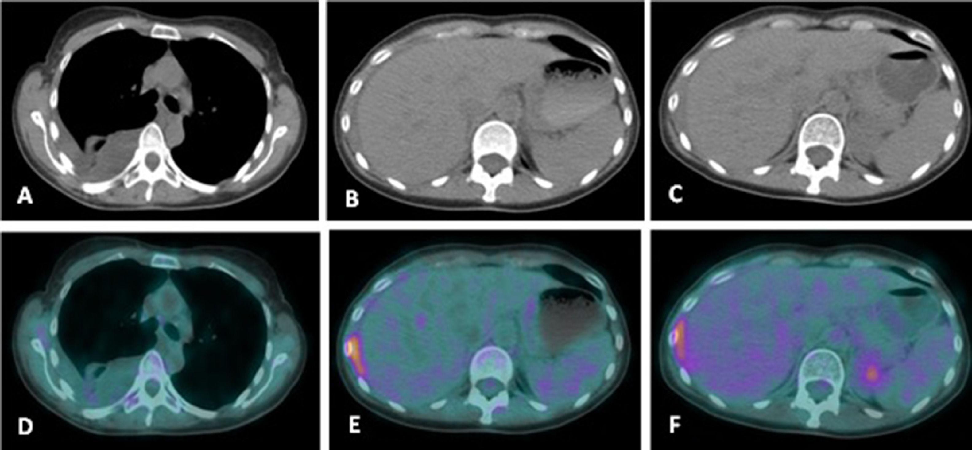Primary pleural lymphoma – A rare diagnosis | Pulmonology