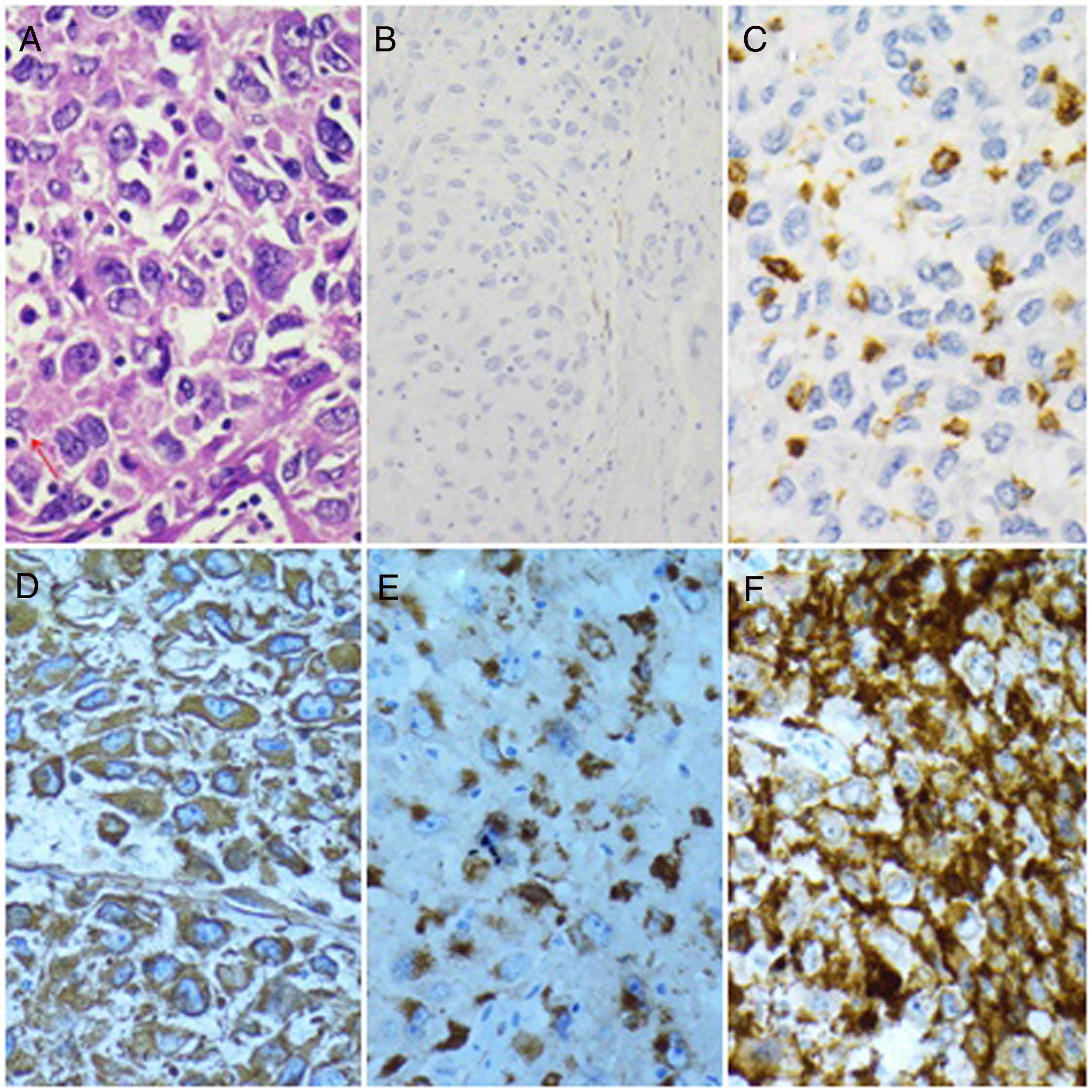 Histiocytic sarcoma of the lymph node: a rare and aggressive ...