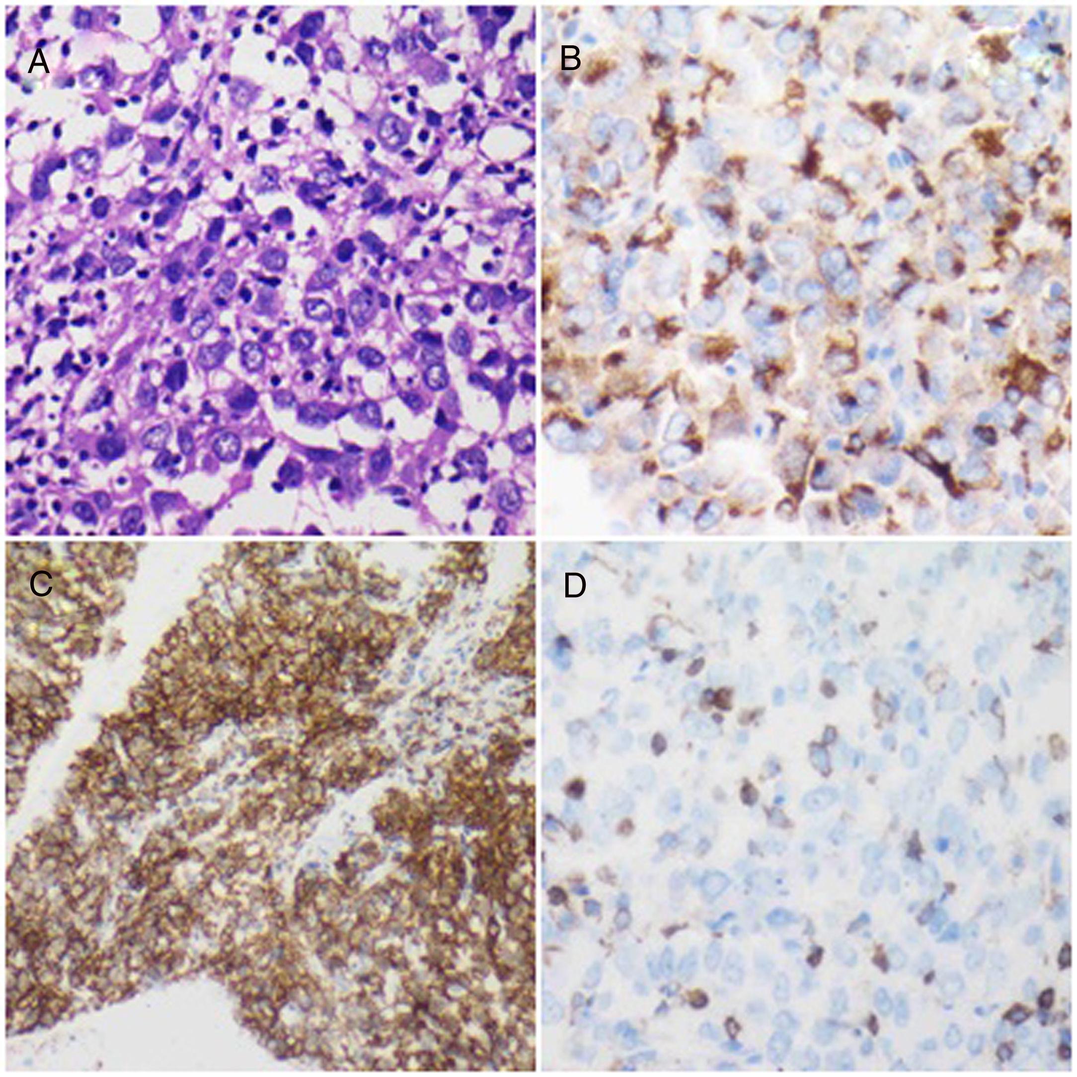 Histiocytic sarcoma of the lymph node: a rare and aggressive ...
