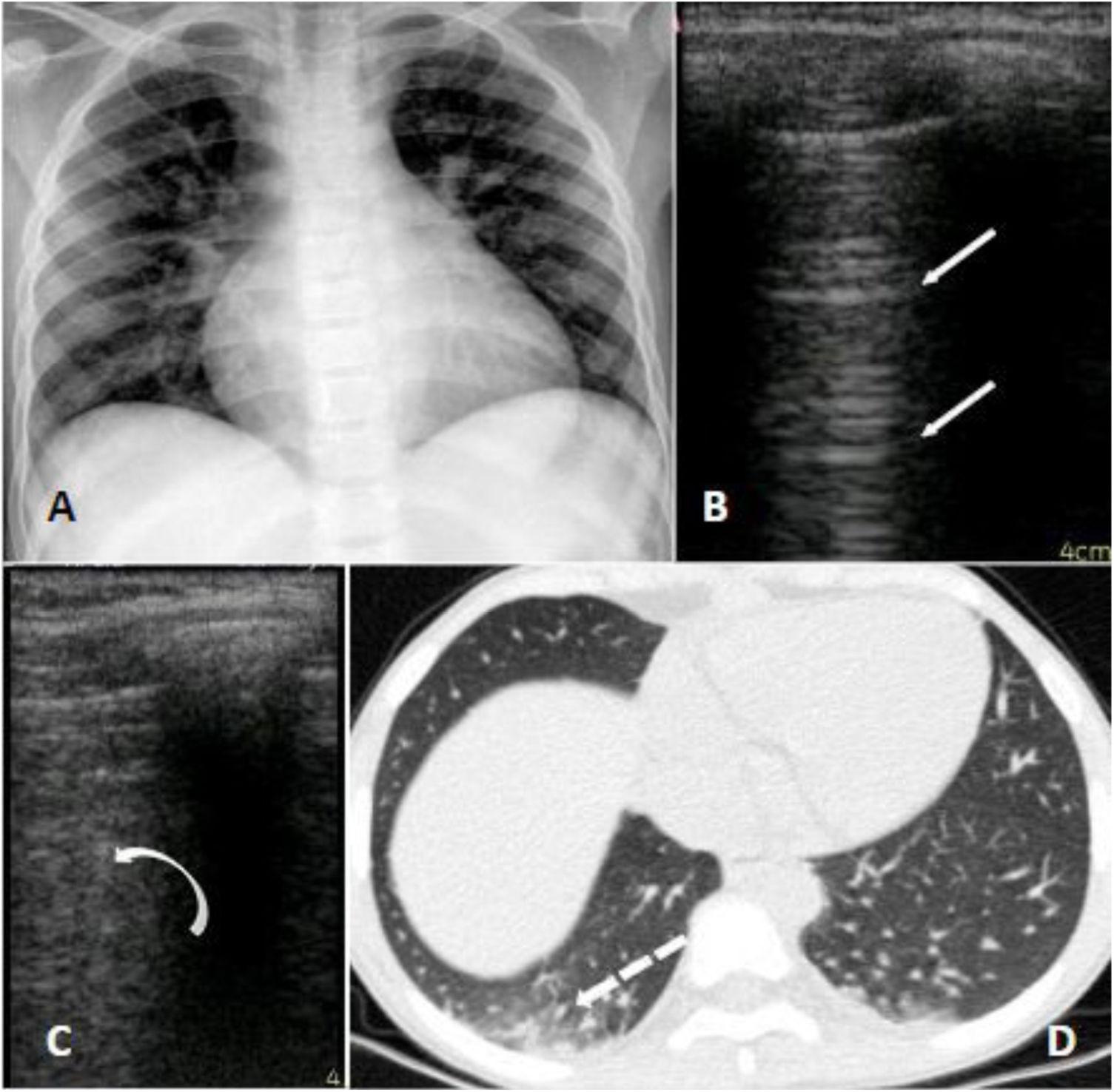 Acute chest syndrome and COVID-19 in sickle cell disease pediatric ...
