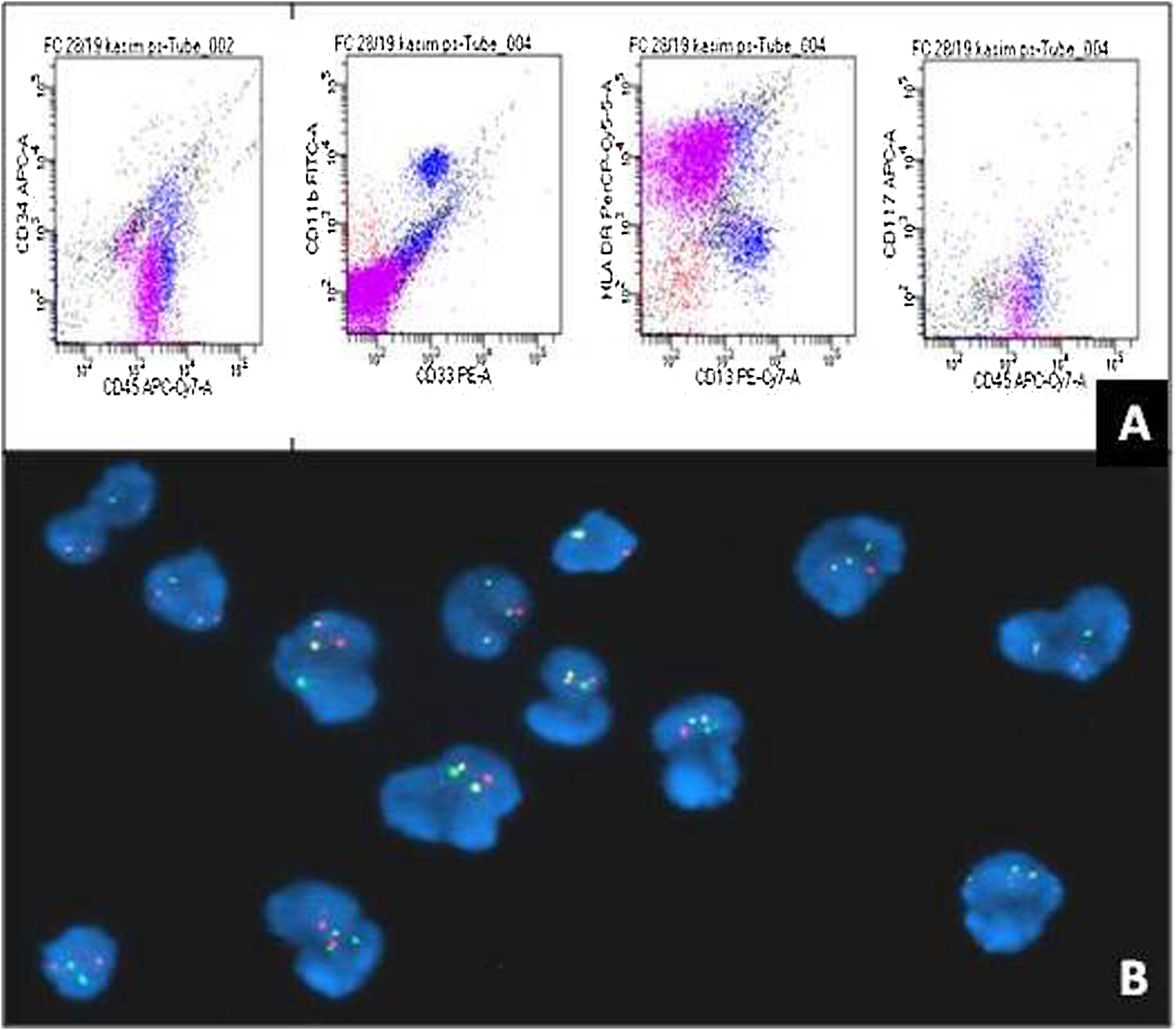 Megakaryocytic blast crisis in chronic myeloid leukiemia: An uncommon ...