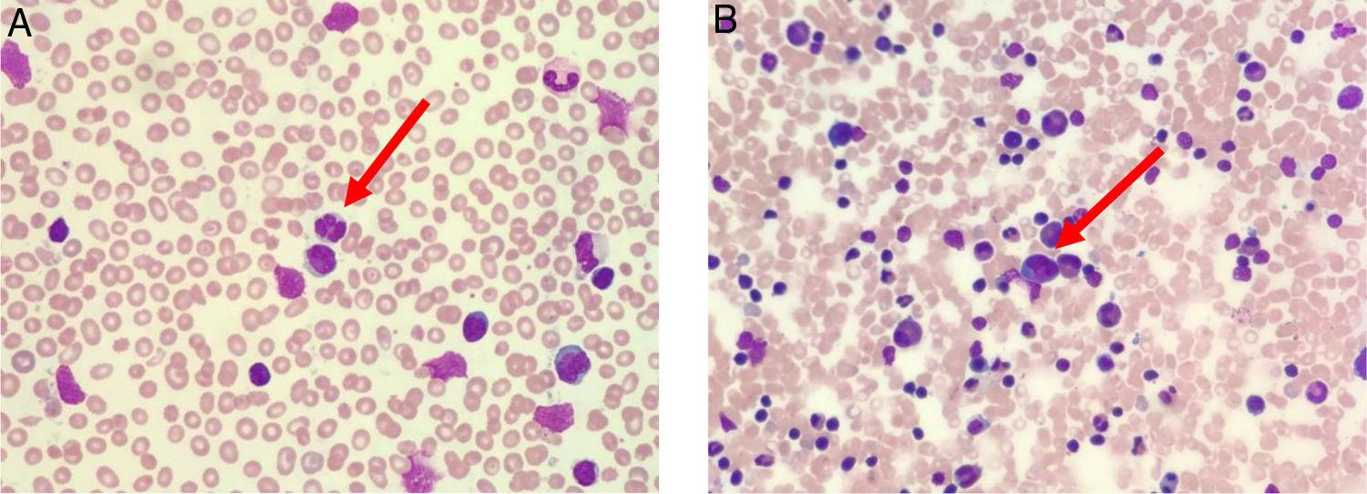 Peripheral lymphocytosis presenting as EBV/HTLV-1 co-infection adult T ...