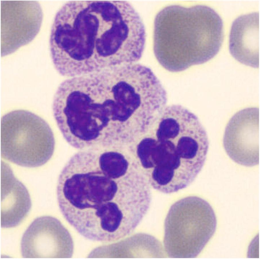 Unusual leukoagglutination: A rare haematological finding | Hematology ...