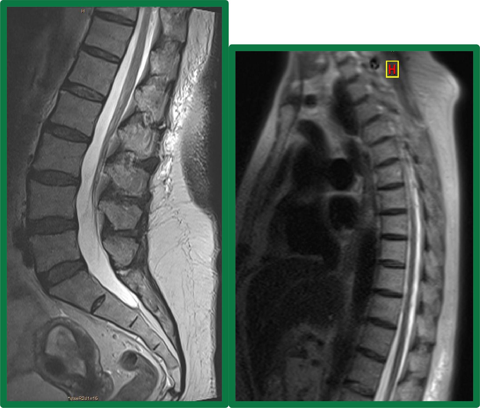 Multiple mononeuritis as a manifestation of graft versus host disease ...