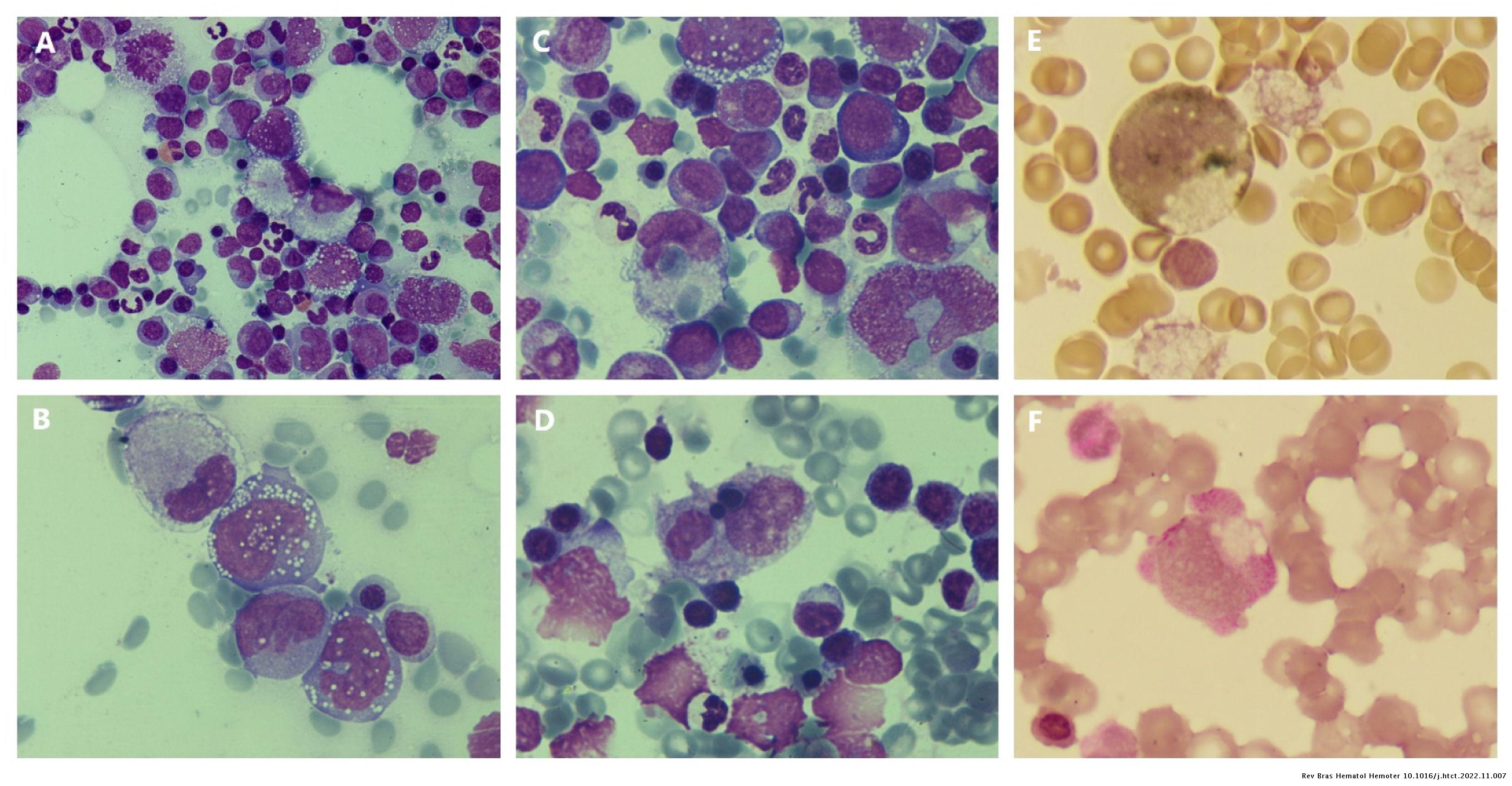 Acute Monocytic Leukaemia With Histiocytic Differentiation And