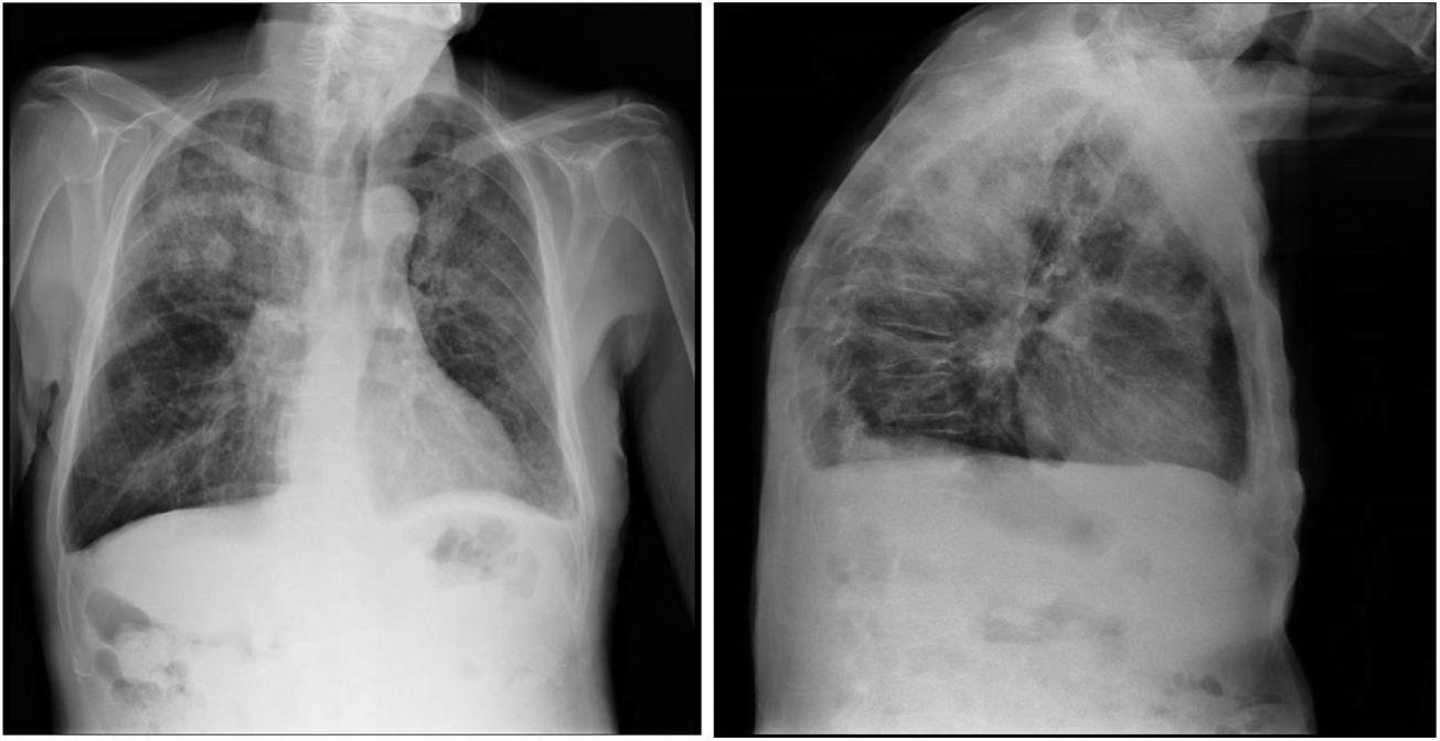 Síndrome de Goodpasture de novo asociado a insuficiencia hepática aguda ...