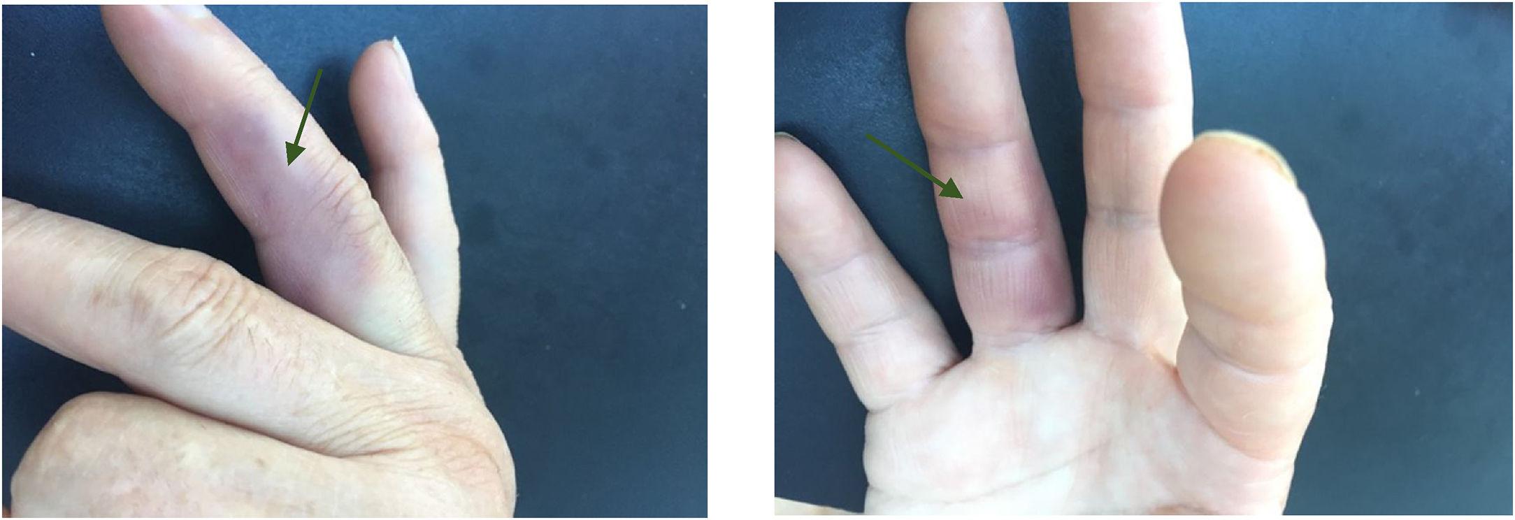 Paroxysmal finger haematoma: A case of Achenbach's syndrome | Medicina ...