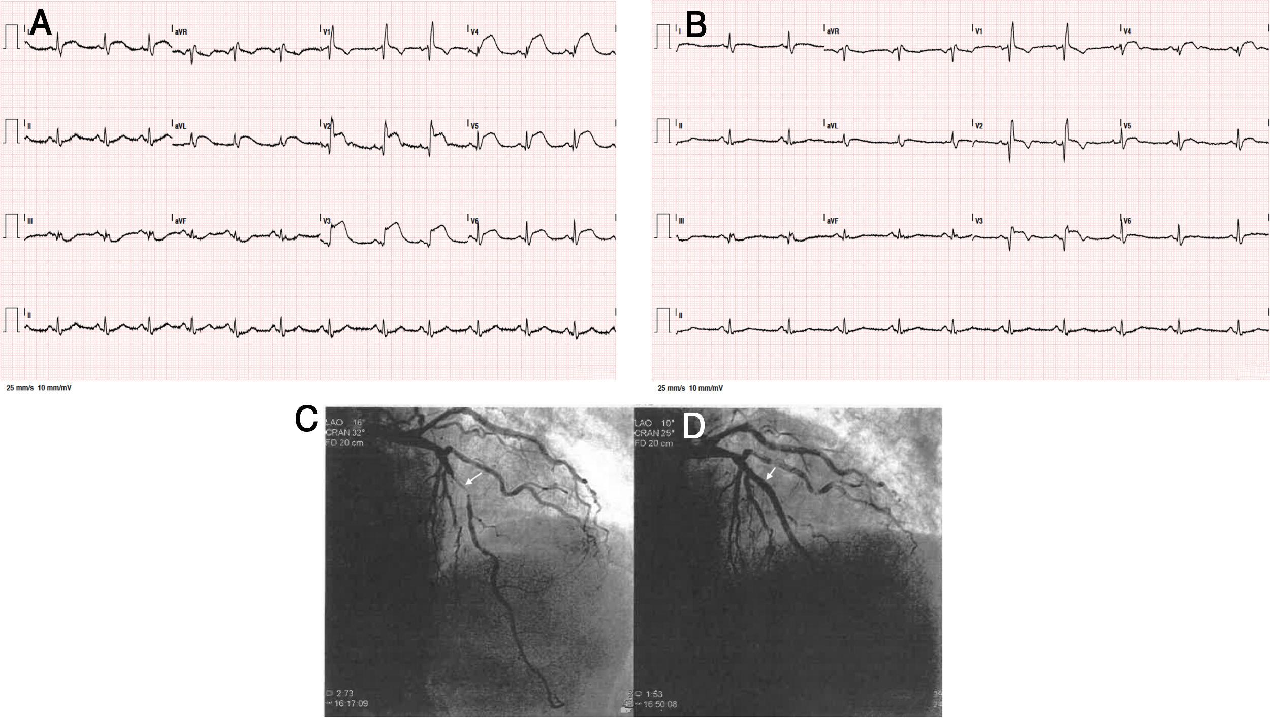 Rotura de septo interventricular secundaria a infarto de miocardio ...