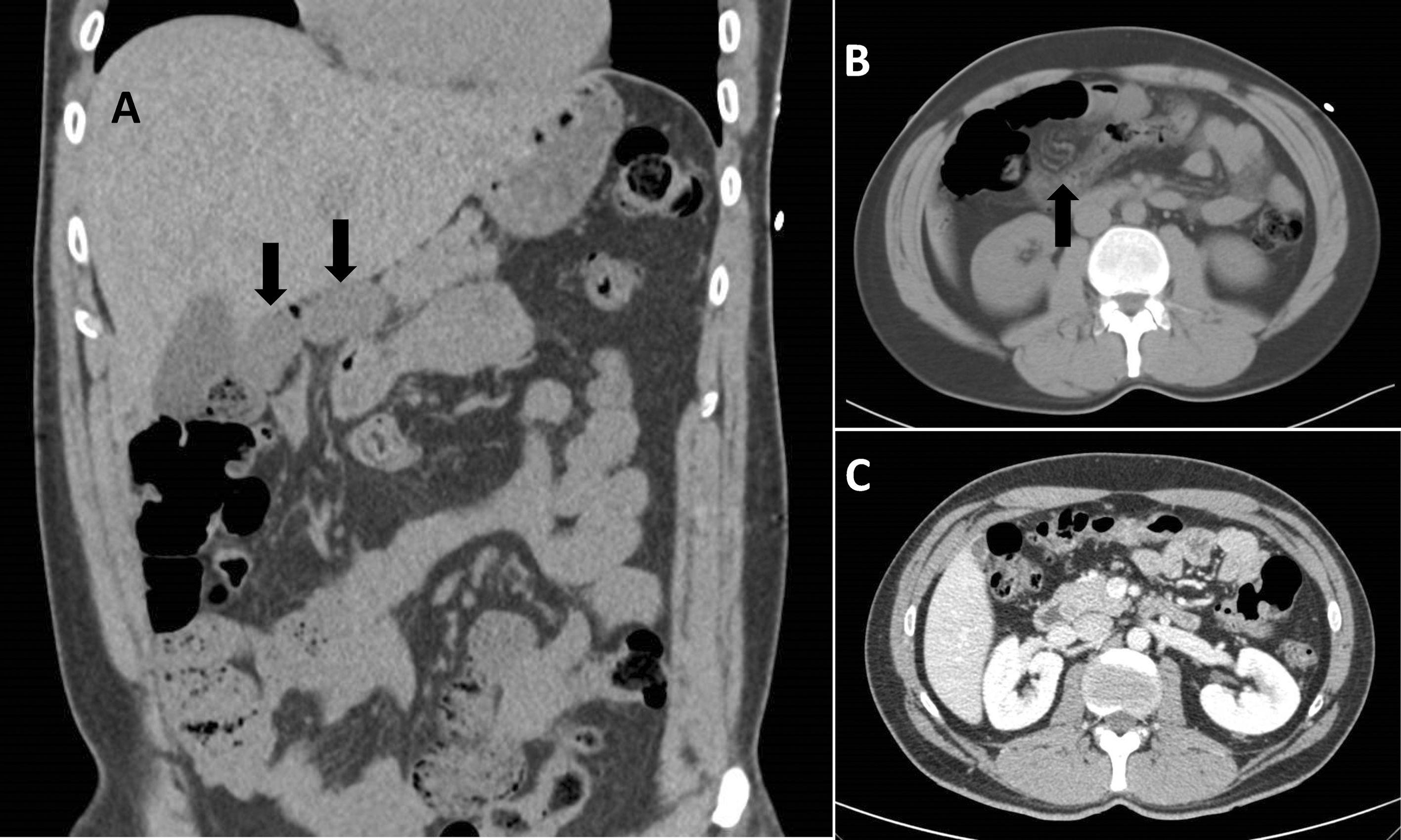 Hernia interna congénita como causa de dolor abdominal | Medicina ...