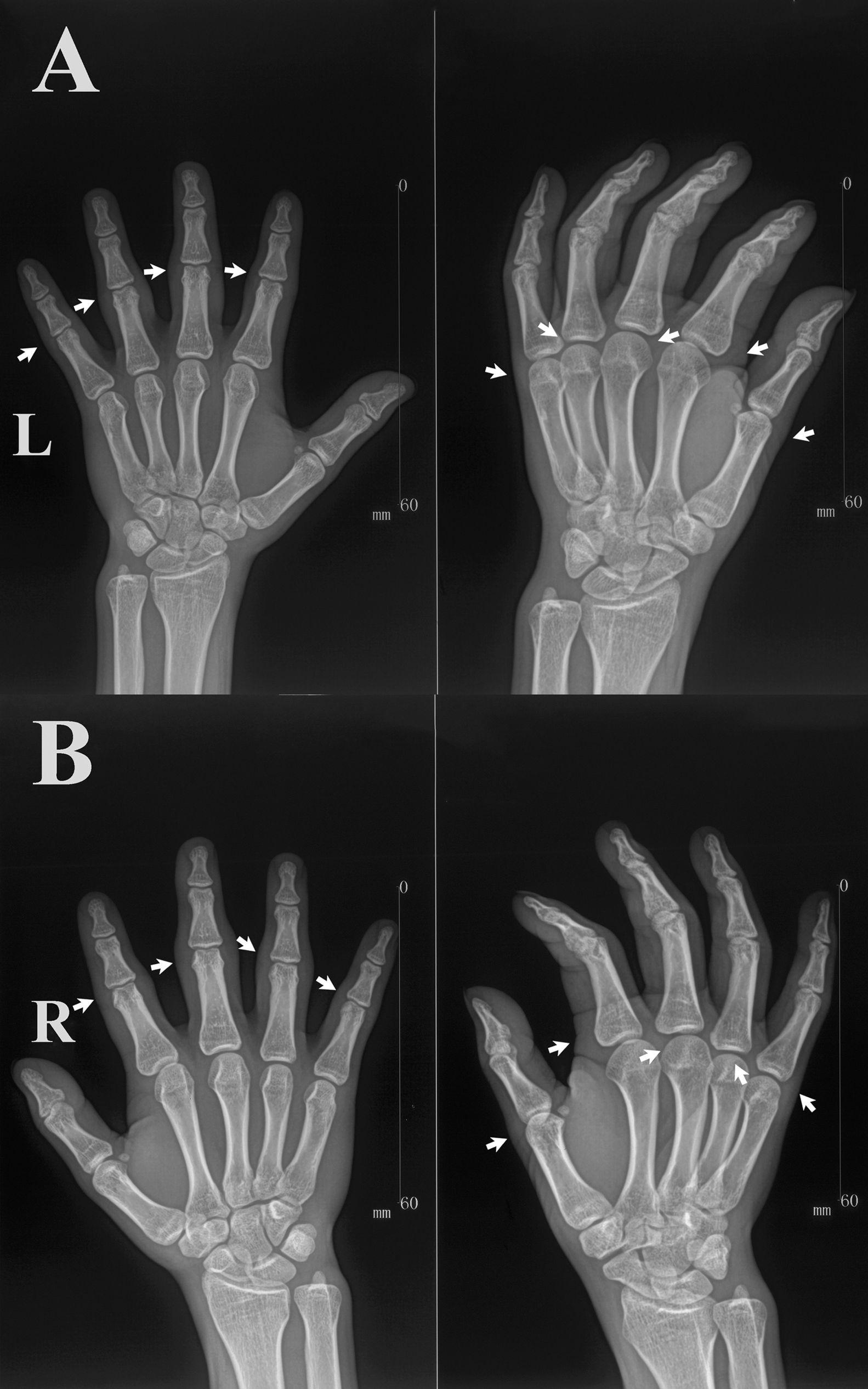 Pachydermodactyly | Medicina Clínica Práctica