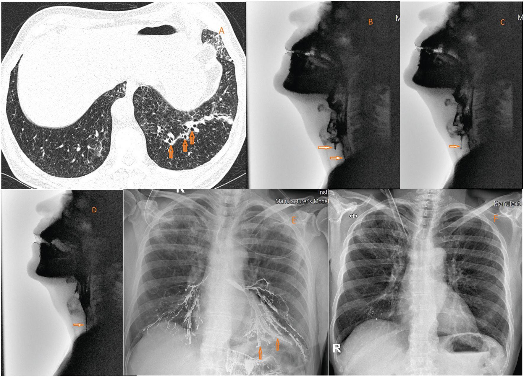 Aspiration and accidental bronchography as a complication of ...