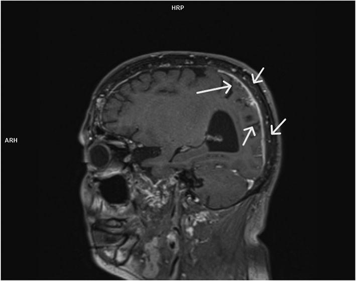 Meningeal involvement in granulomatosis with polyangiitis | Medicina ...