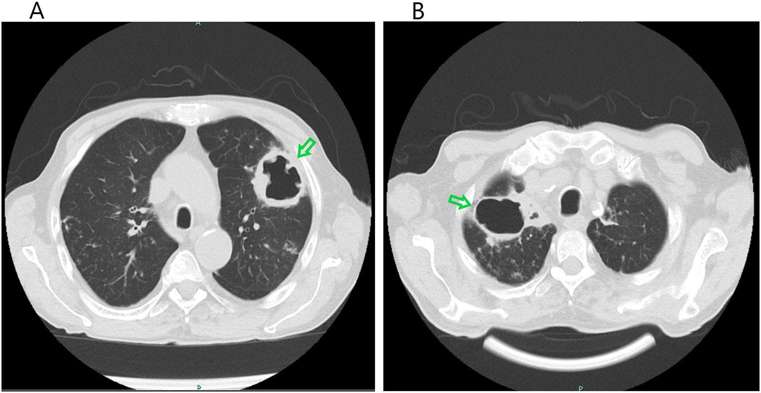 Urinary tract infection and pulmonary abscess, a rare association ...