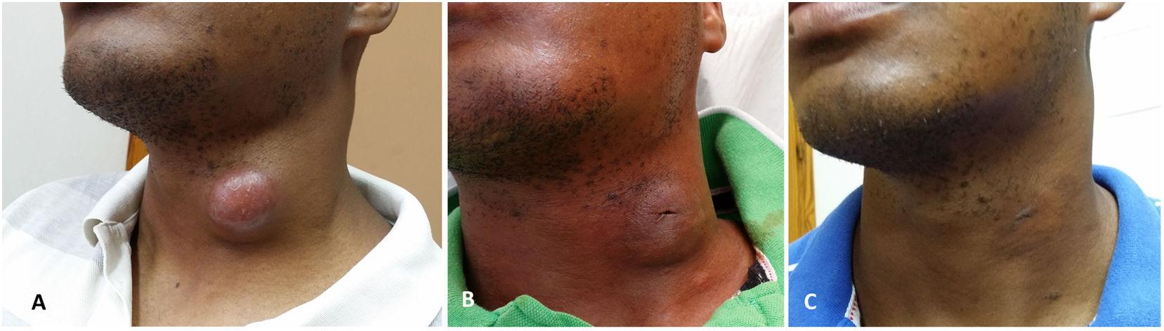 Linfadenitis tuberculosa cervical | Atención Primaria Práctica