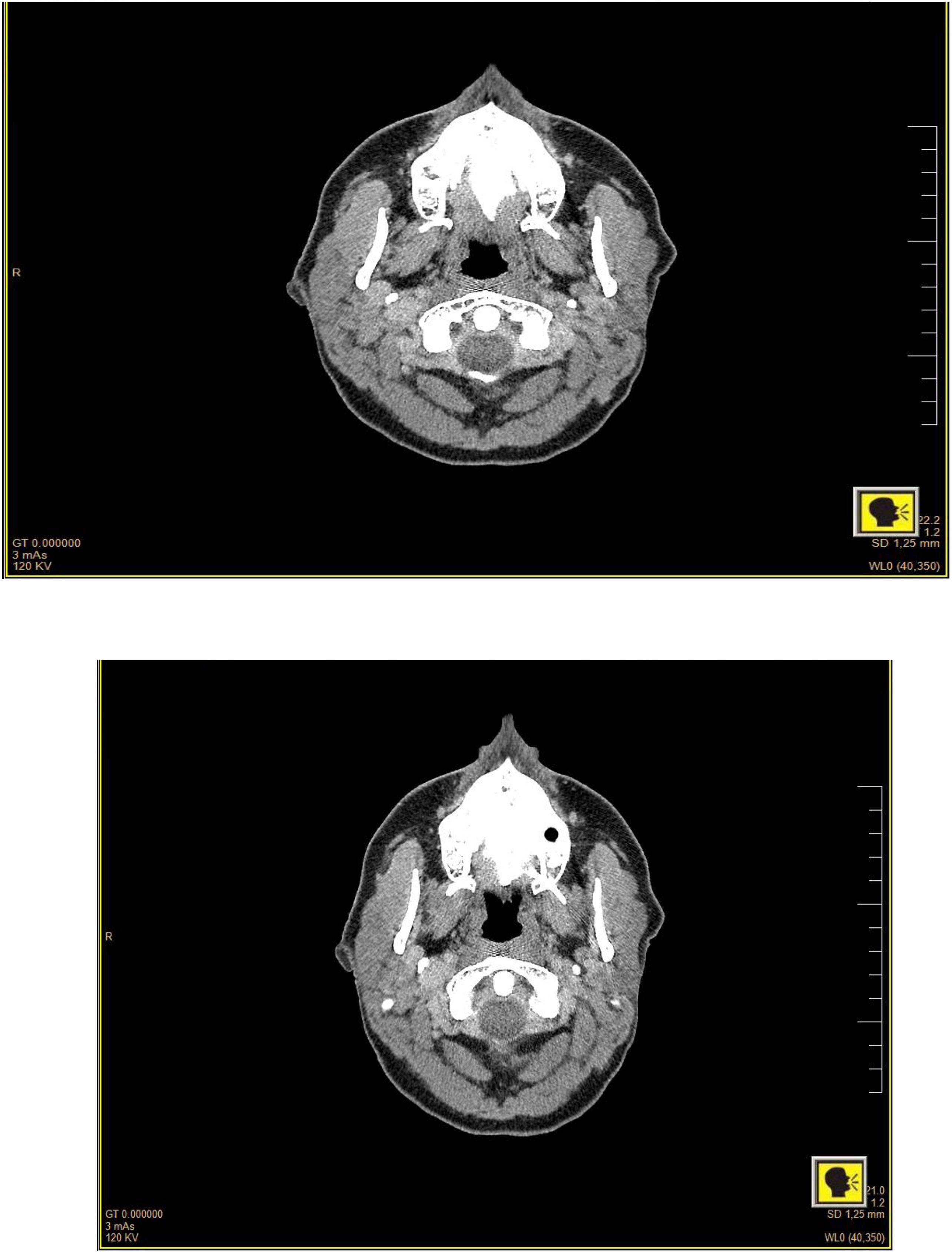 Torus palatinus en 2 hermanas | Atención Primaria Práctica