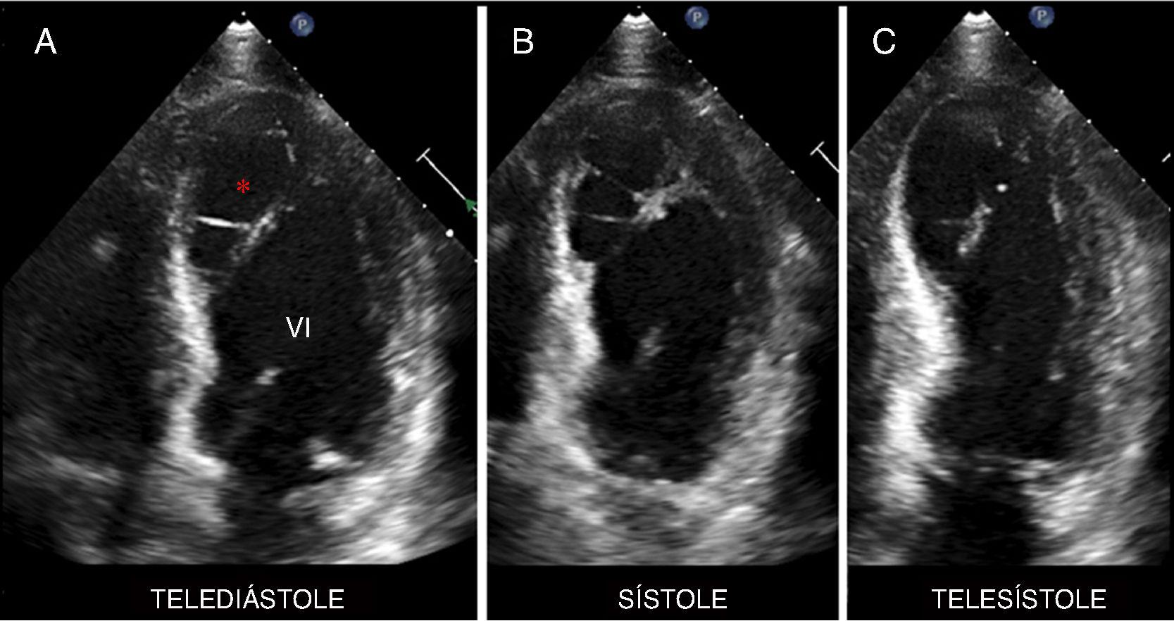 Disección del septo interventricular en el infarto de miocardio | REC ...