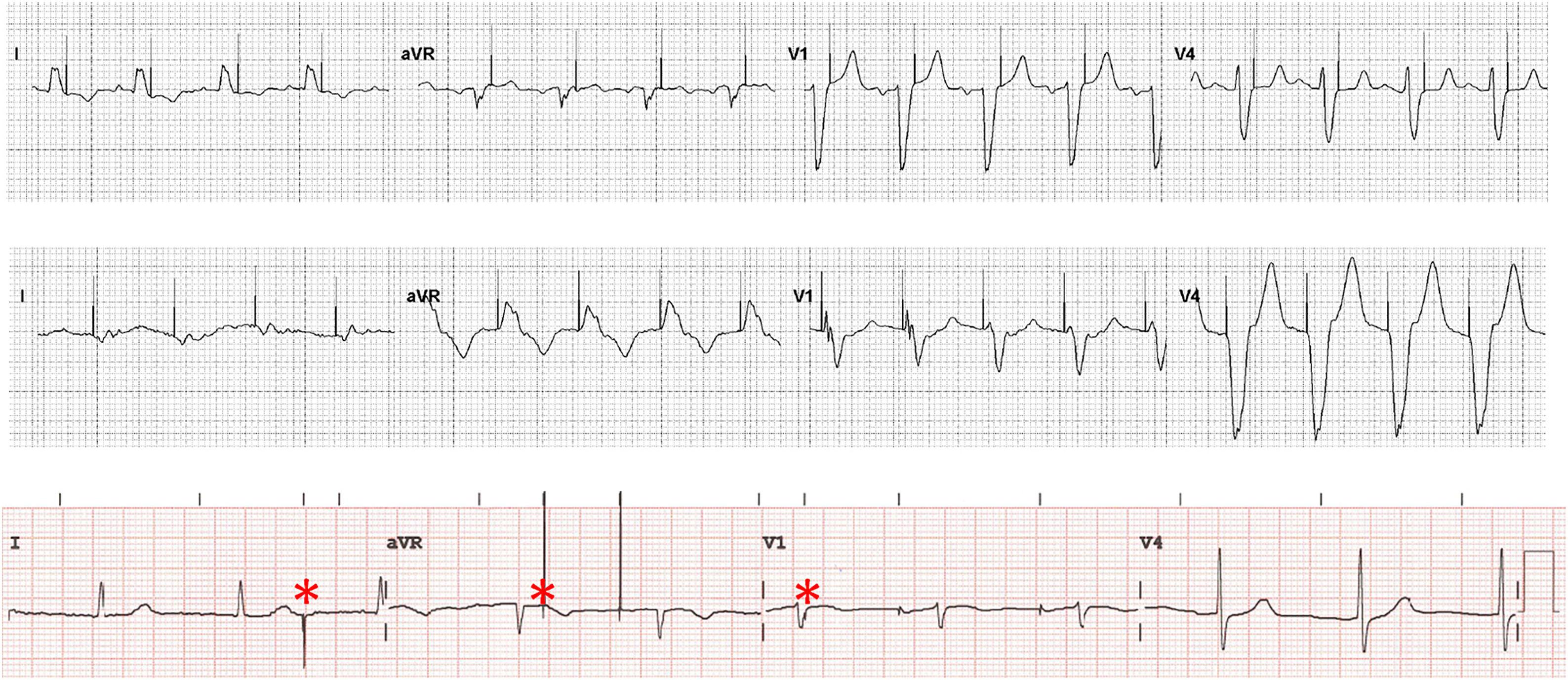 Advanced pacing algorithms resembling device malfunction: A ...
