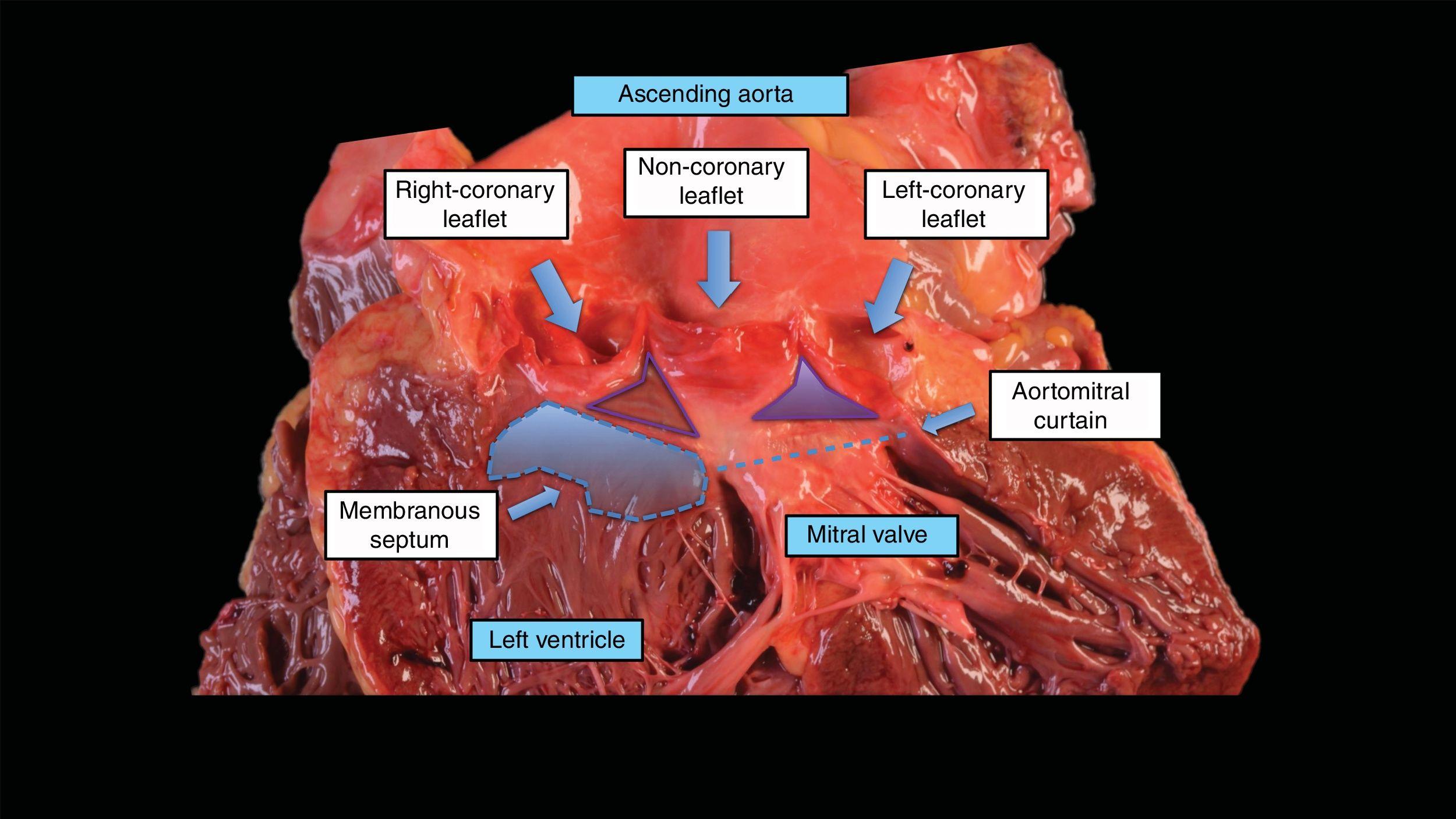 Conduction disturbances after transcatheter aortic valve implantation ...