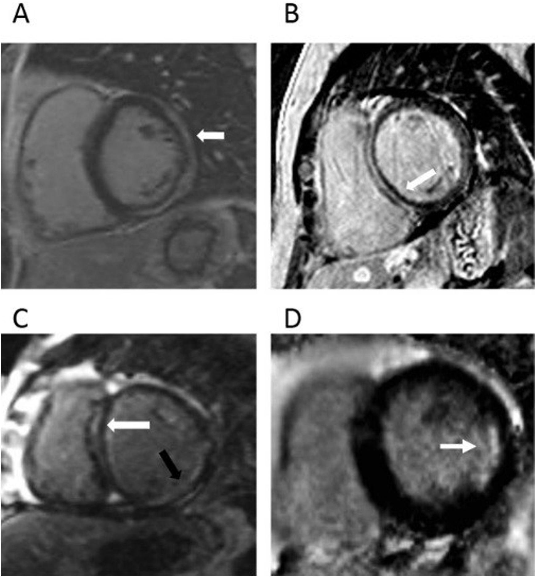 Predictores de muerte súbita en miocardiopatía dilatada: más allá de la ...