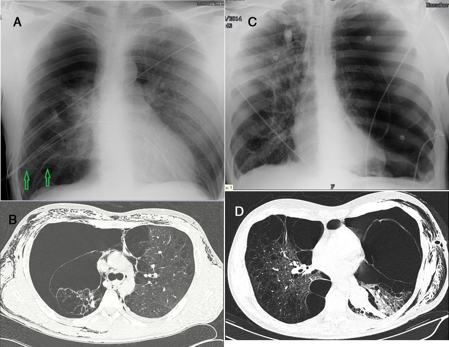 Vanishing Lung Syndrome: Fifteen Years After Bullectomy | Open ...
