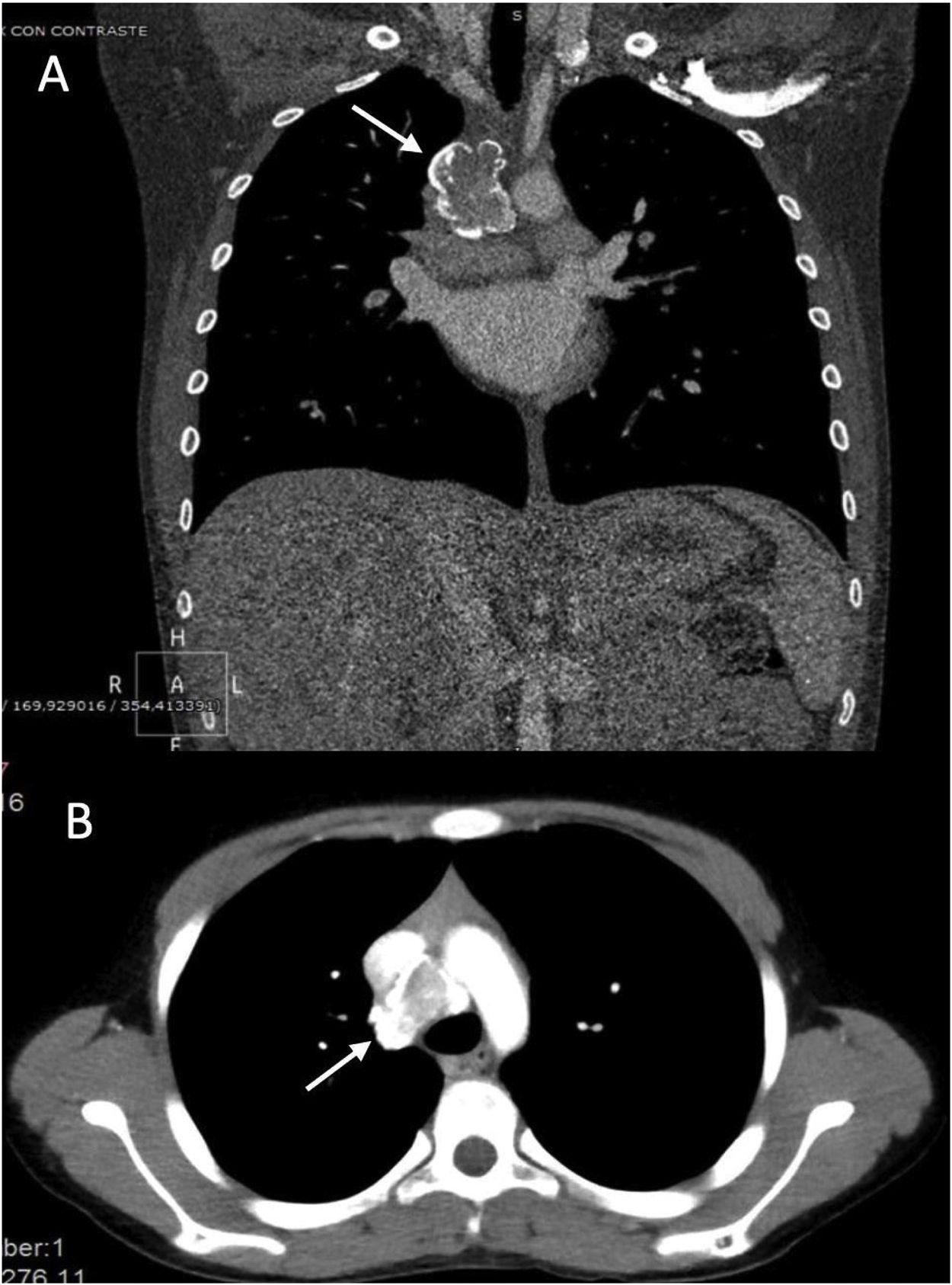 Calcification Of Lymph Nodes
