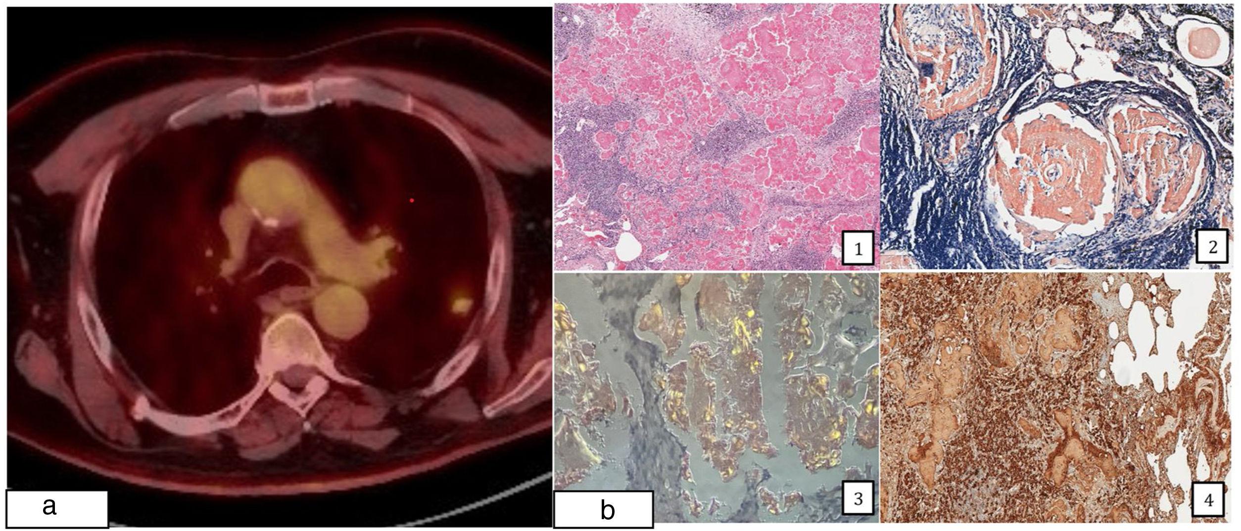 Nodular Pulmonary Amyloidosis: A Rare Clinical Entity | Open ...
